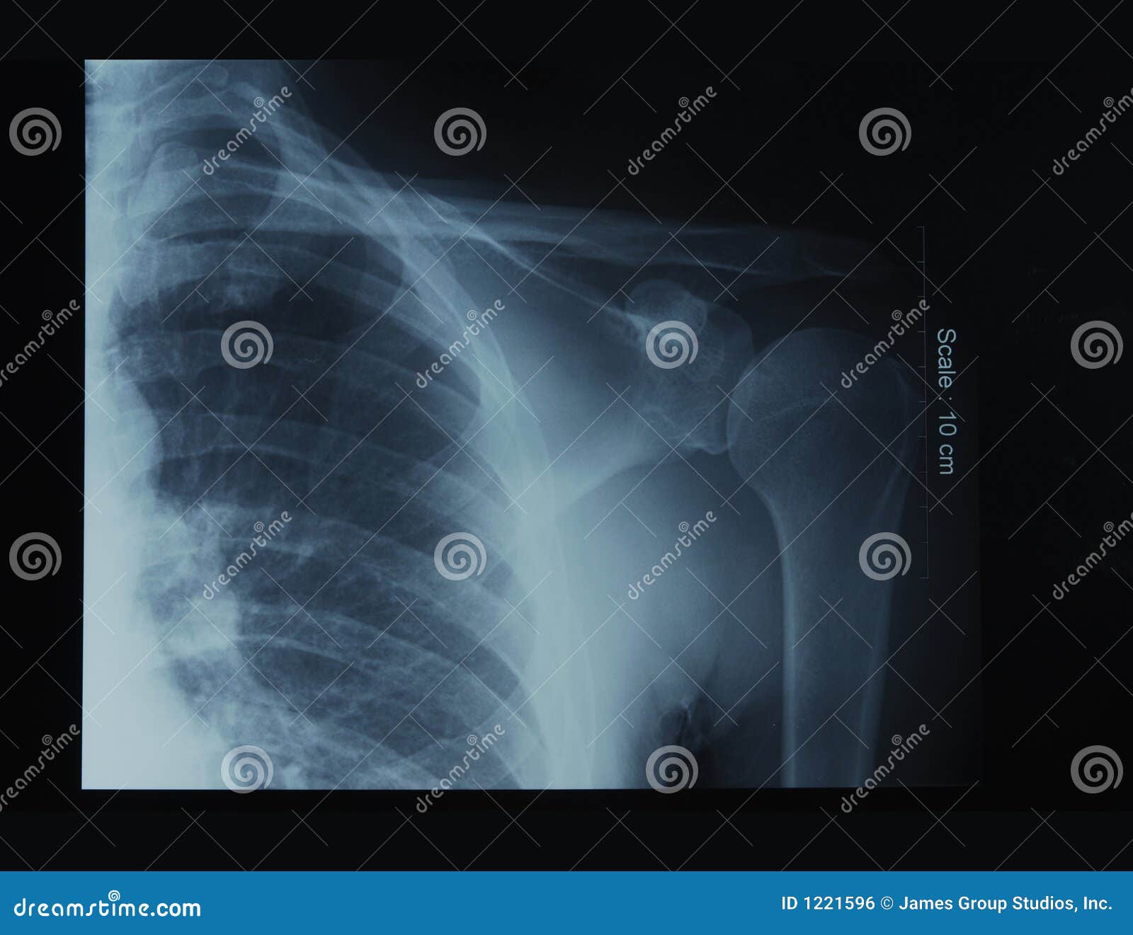 X-ray film of shoulder stock photo. Image of clinic, film - 1221596