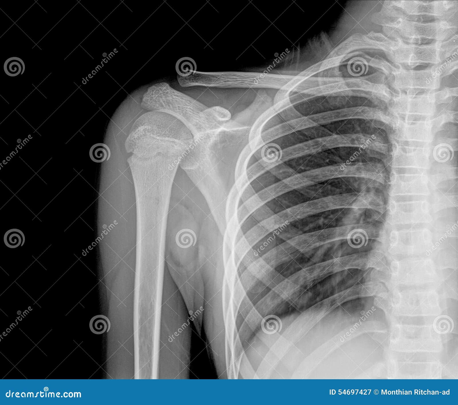 Shoulder Fracture, X Ray Stock Photography | CartoonDealer.com #111803690
