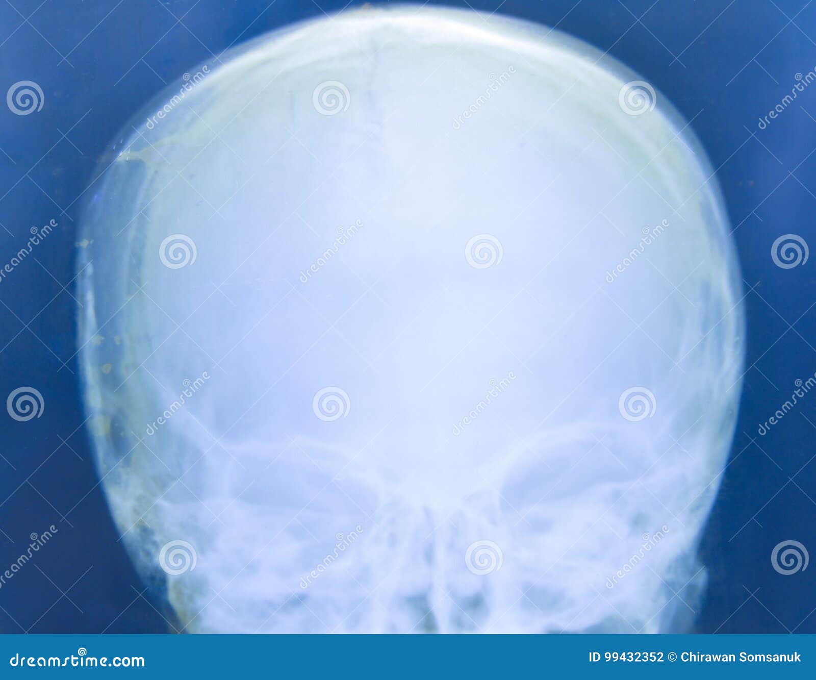 Film X-ray Skull And Headache. (Stroke,Cerebrovascular Accident ...