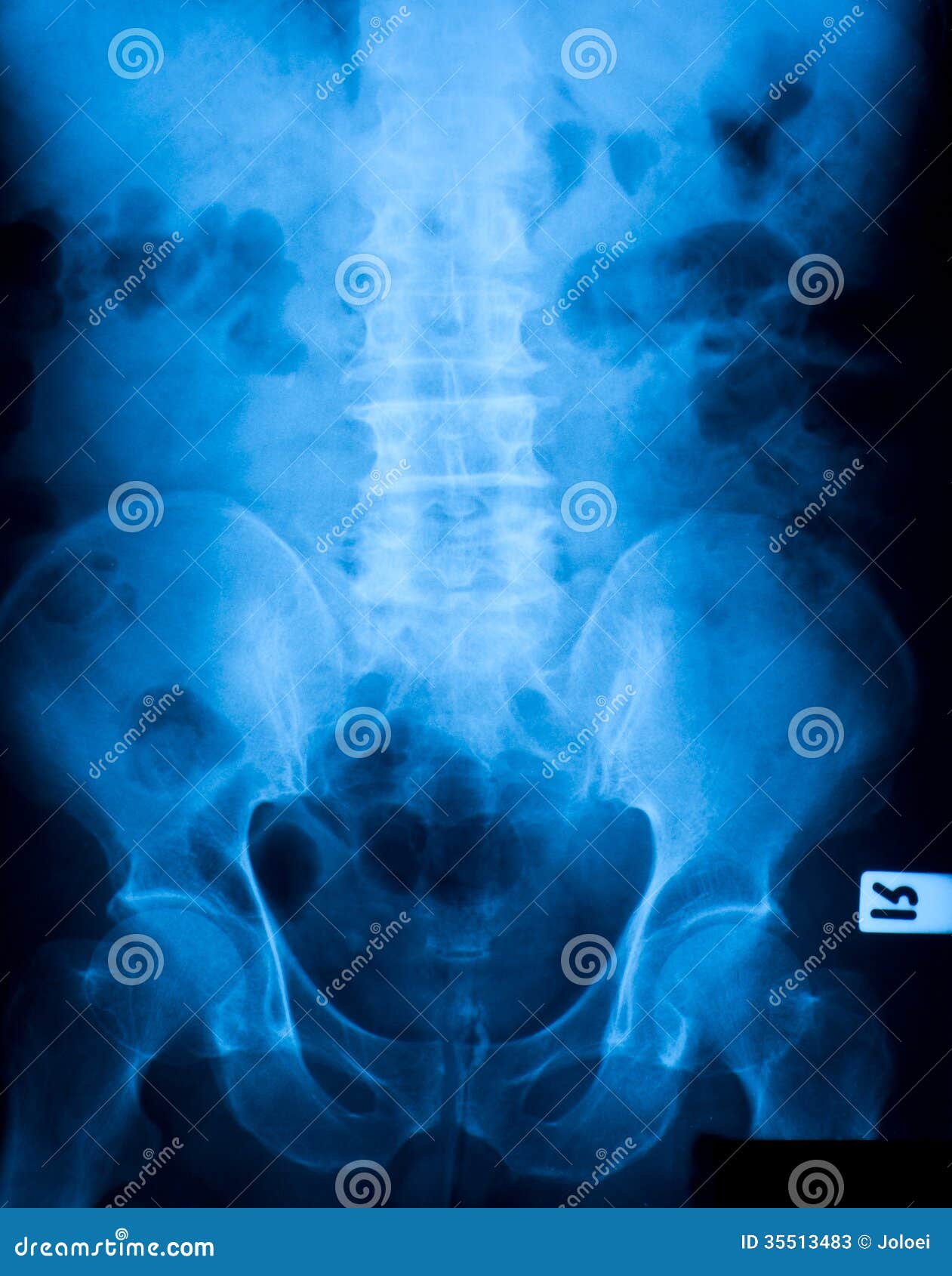 Film X-ray KUB Kidney - Ureter - Bladder Show Right Renal Stone Round ...