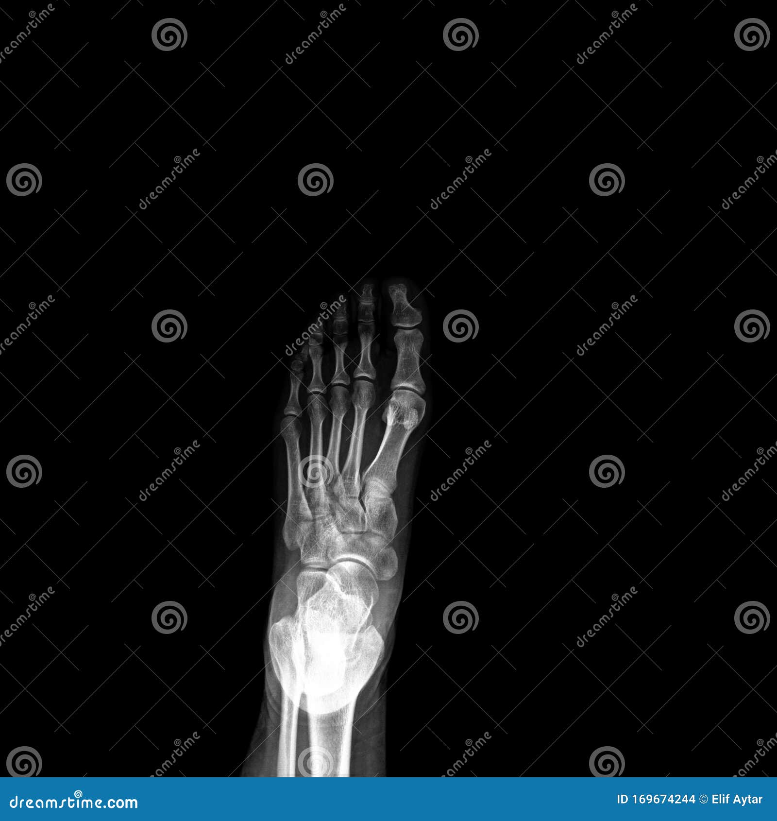 X-ray of Foot on Black Background Stock Photo - Image of injury, care ...