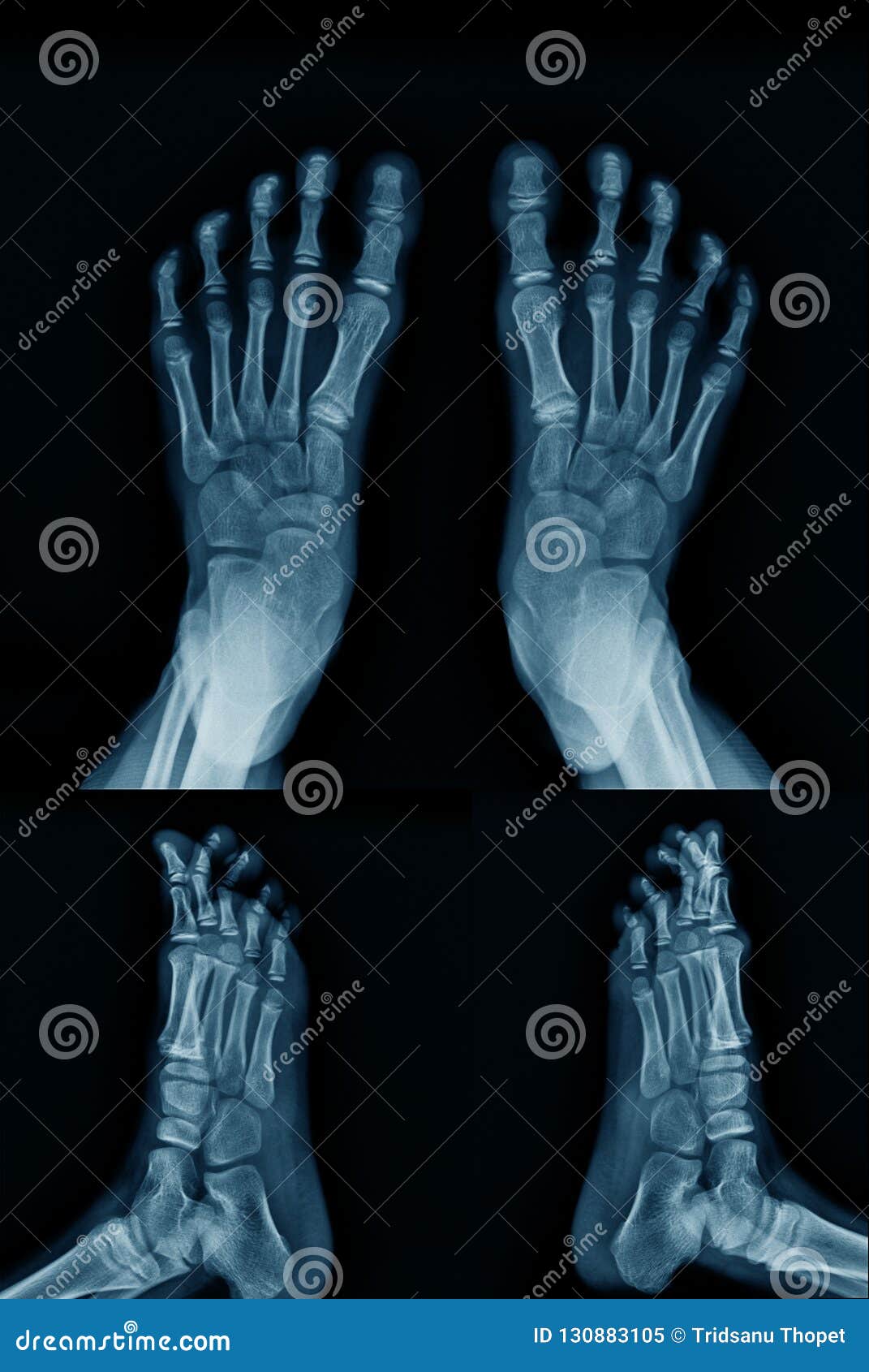 X-ray Foot Both Side with Lateral View Both Side Stock Image - Image of ...