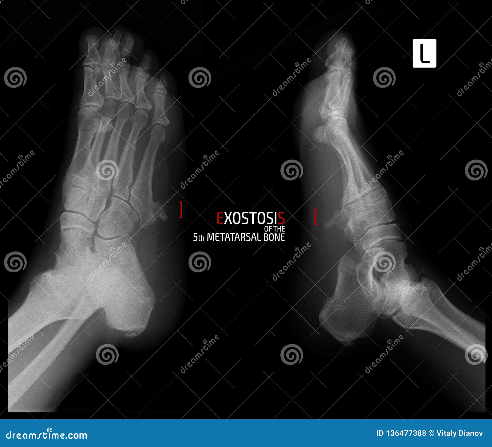 Exostosis Of Foot