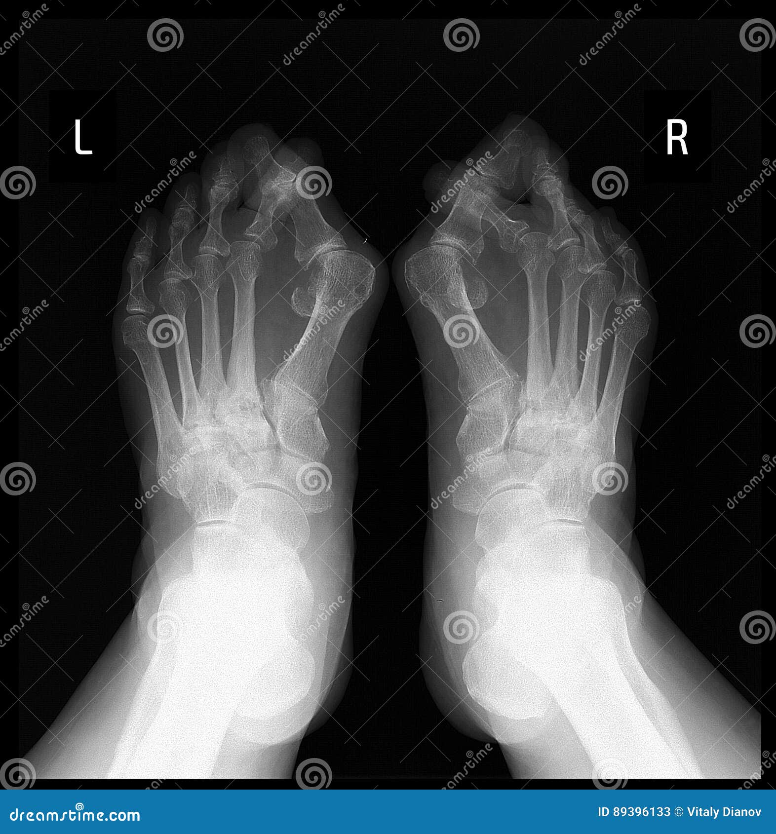 X-ray foot. Hallux valgus. stock image. Image of hospital - 89396133