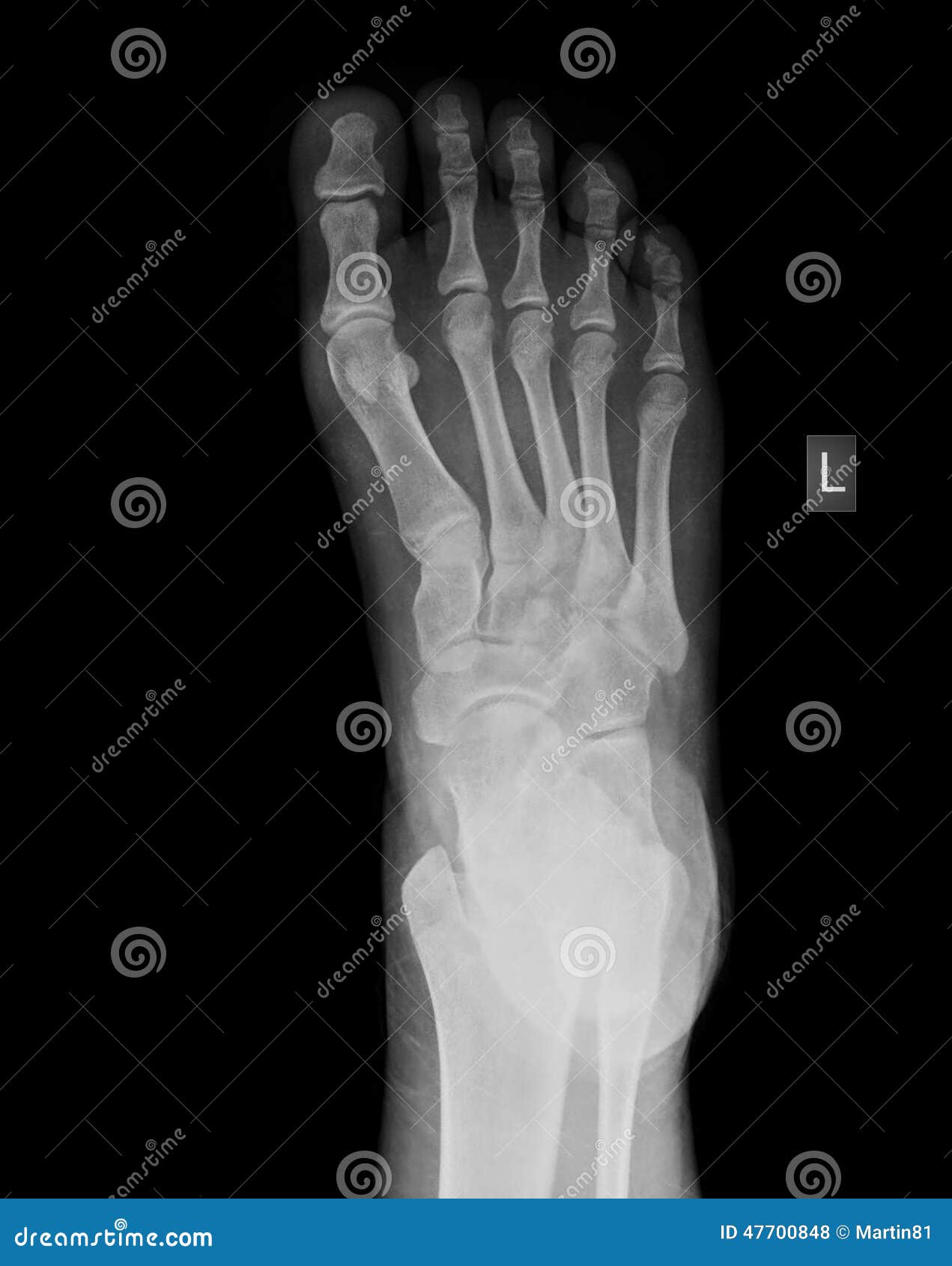 X-ray Of Foot Stock Photo - Image: 47700848