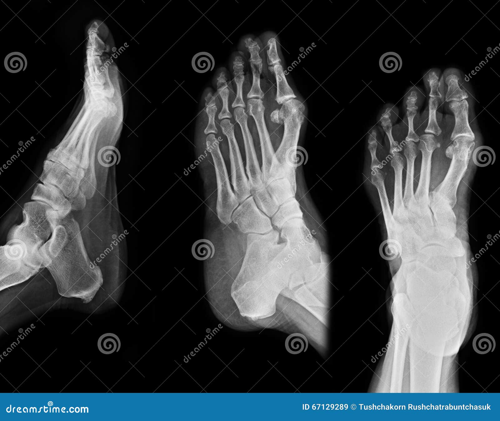 X-ray of foot stock image. Image of ankle, film, broken - 67129289