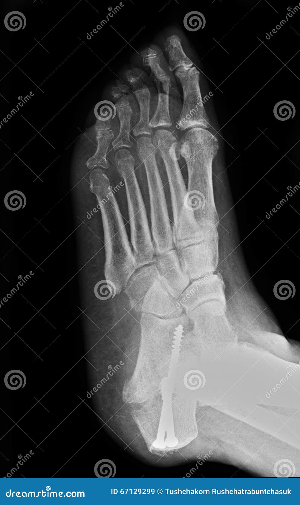 X-ray of foot stock image. Image of examination, radiology - 67129299