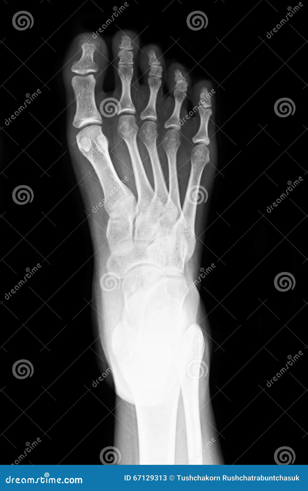 X-ray of foot stock image. Image of patient, scan, male - 67129313