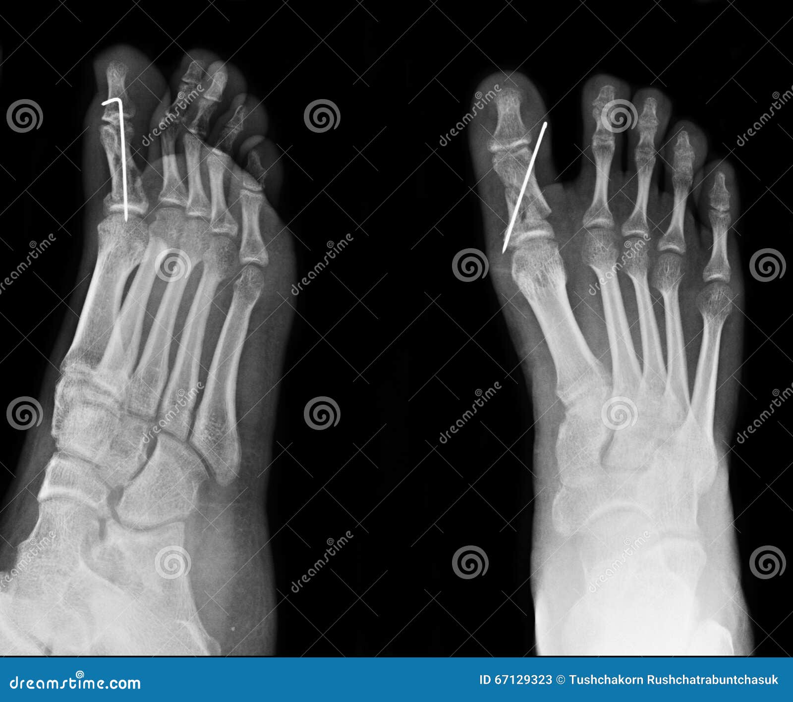 X-ray of foot stock image. Image of injury, external - 67129323