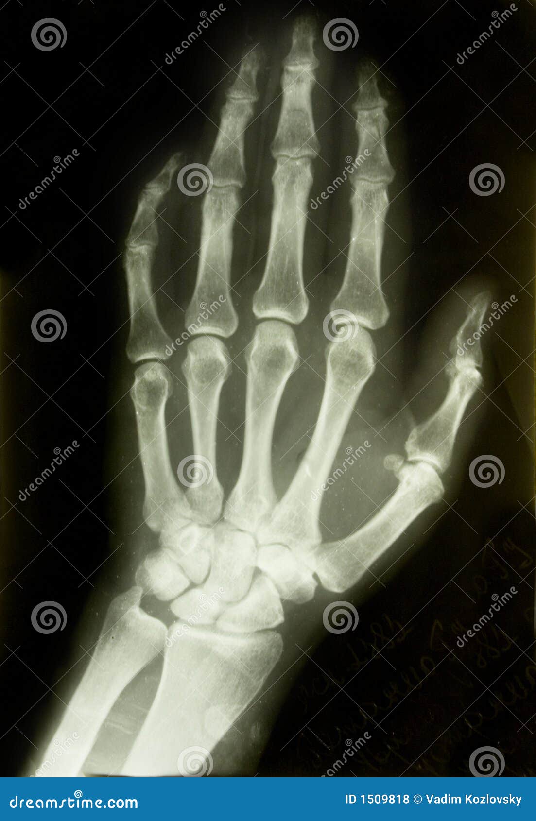 X-ray Front Picture of the Palm Stock Photo - Image of surgeon, joint ...