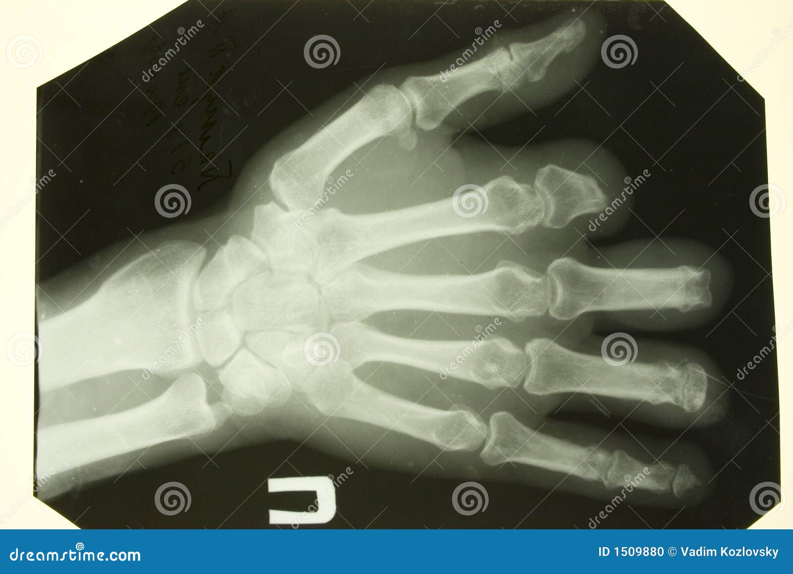 Chest Deformity, Birth Defect. Strong Deformity. Pectus Excavatus ...