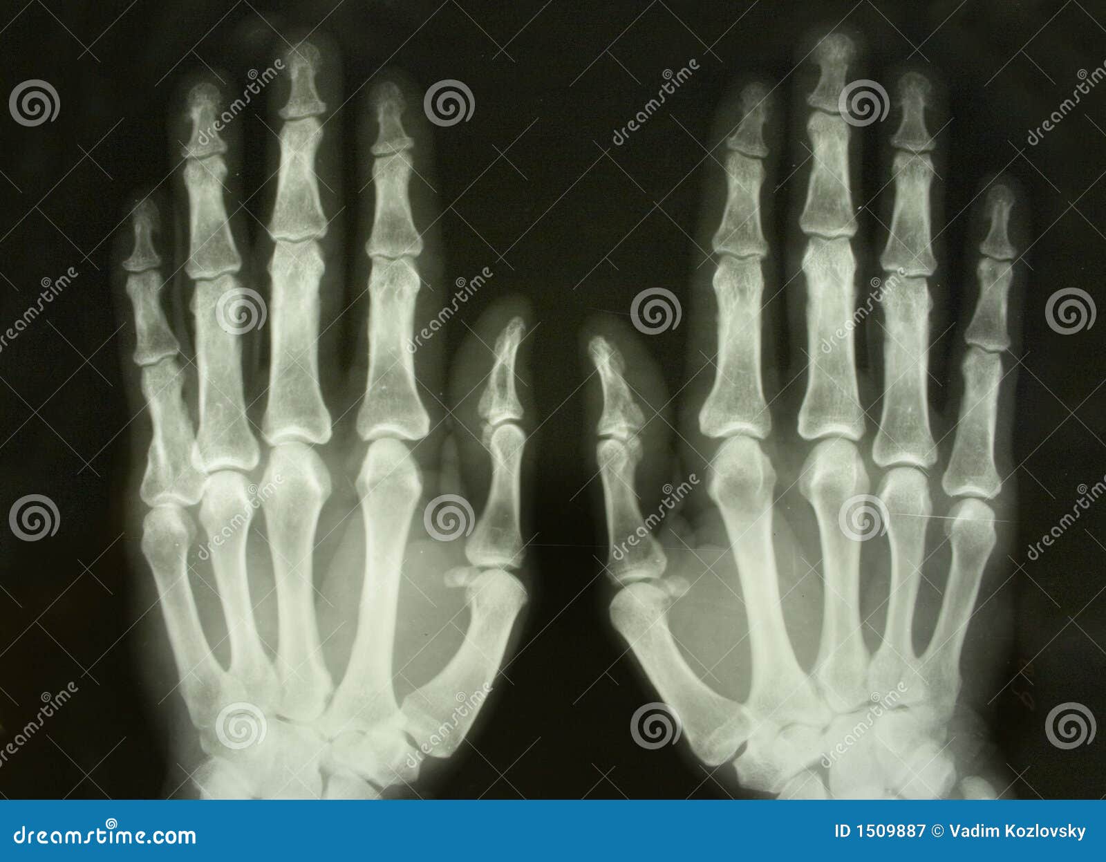 Chest Deformity, Birth Defect. Strong Deformity. Pectus Excavatus ...
