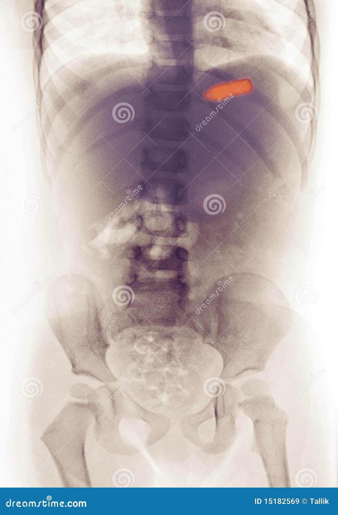 X-ray of a Girl Who Swallowed a Toy Stock Image - Image of child ...