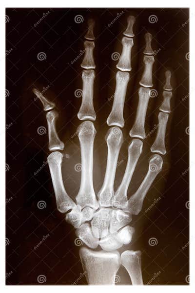 X-ray of hand stock photo. Image of fingers, hospital - 1583750