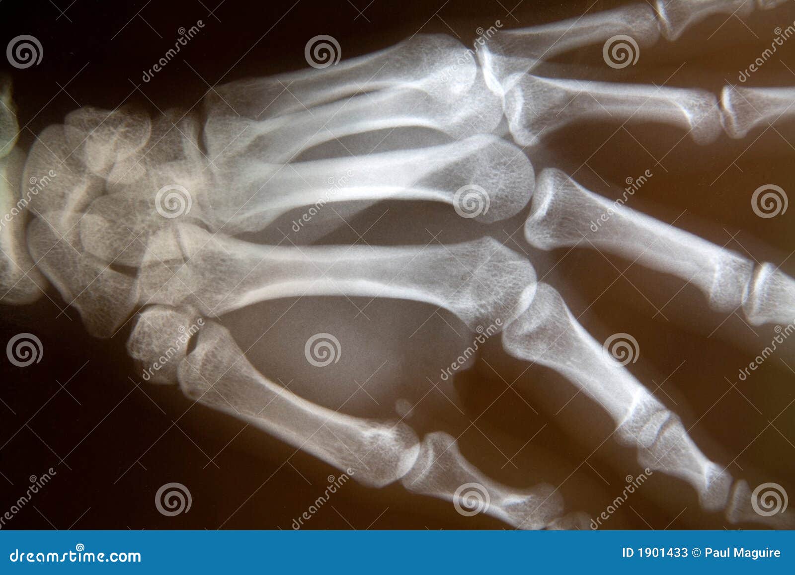 X-ray of hand stock image. Image of imaging, diagnosis - 1901433