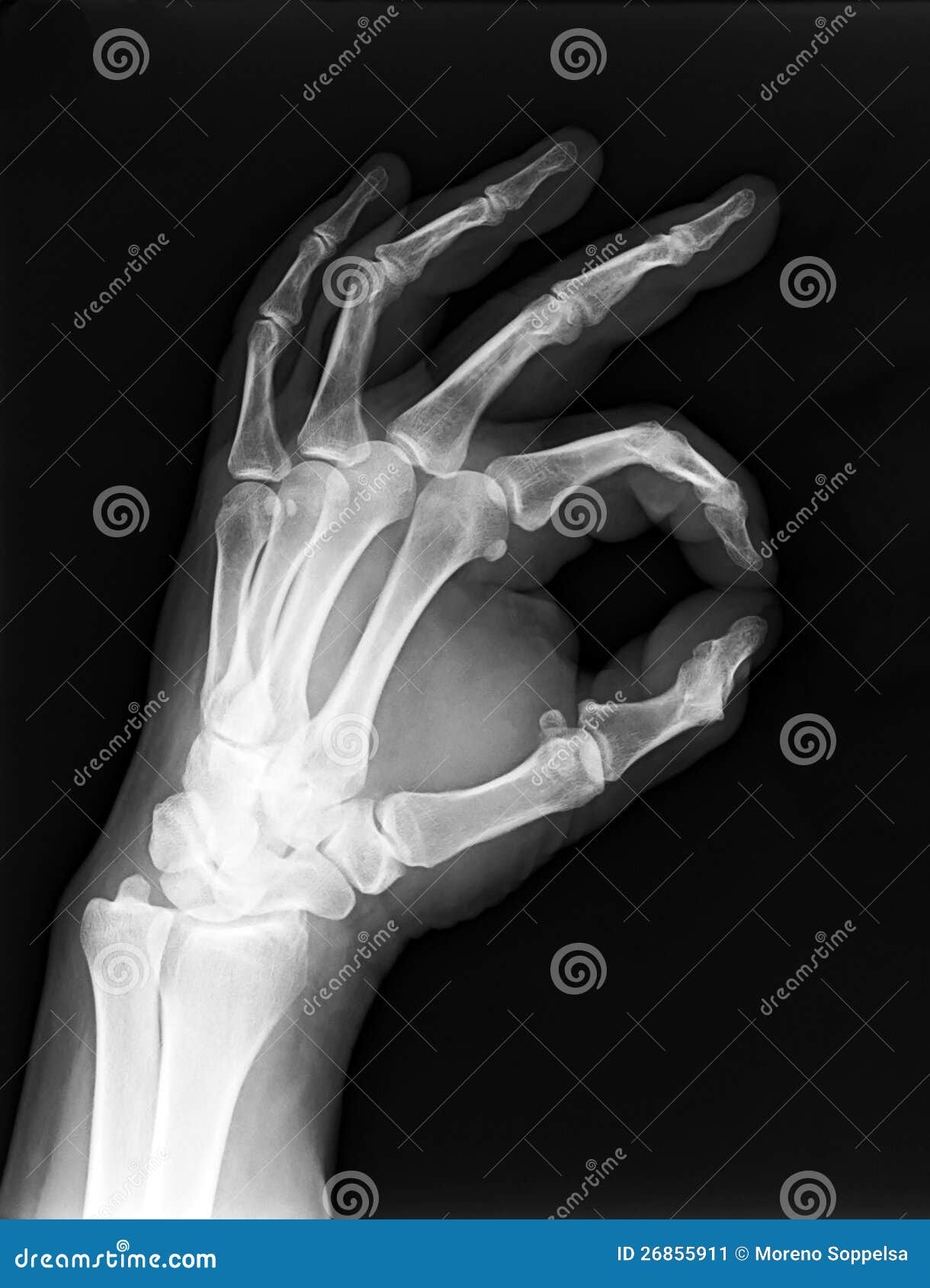 X Ray Of Hand