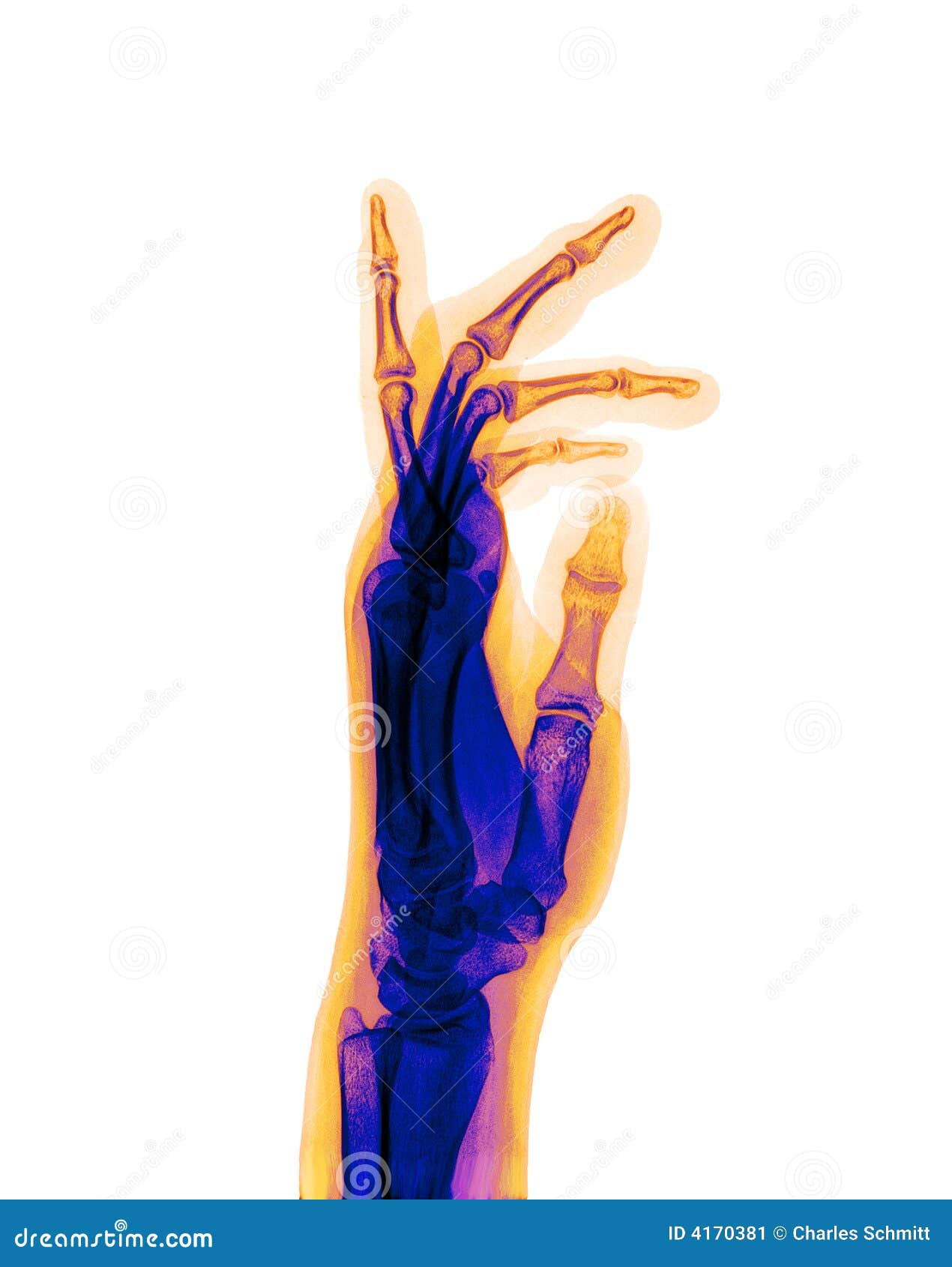 X-ray Hand stock illustration. Illustration of phalanx - 4170381