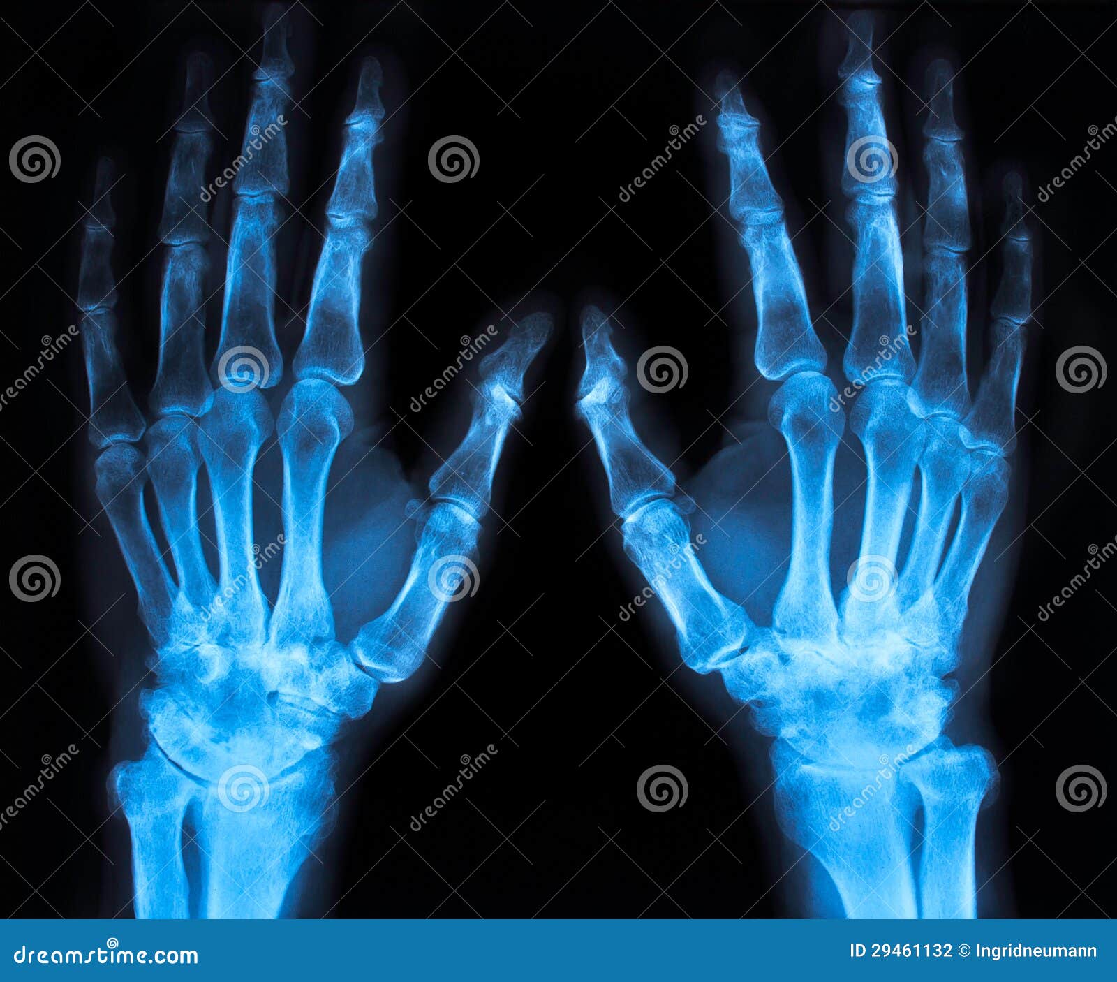 X-ray of an hand (blue) stock photo. Image of ailing - 29461132