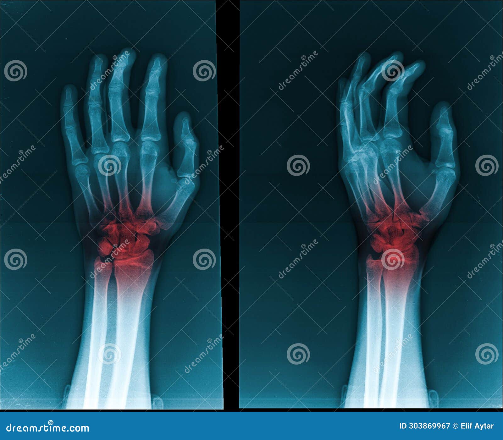 X-ray Hand and Finger, Highlighted in Red Stock Image - Image of ...