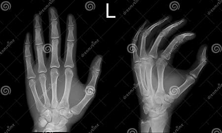 X-ray Hand Frontal Oblique View Normal Stock Image - Image of middle ...