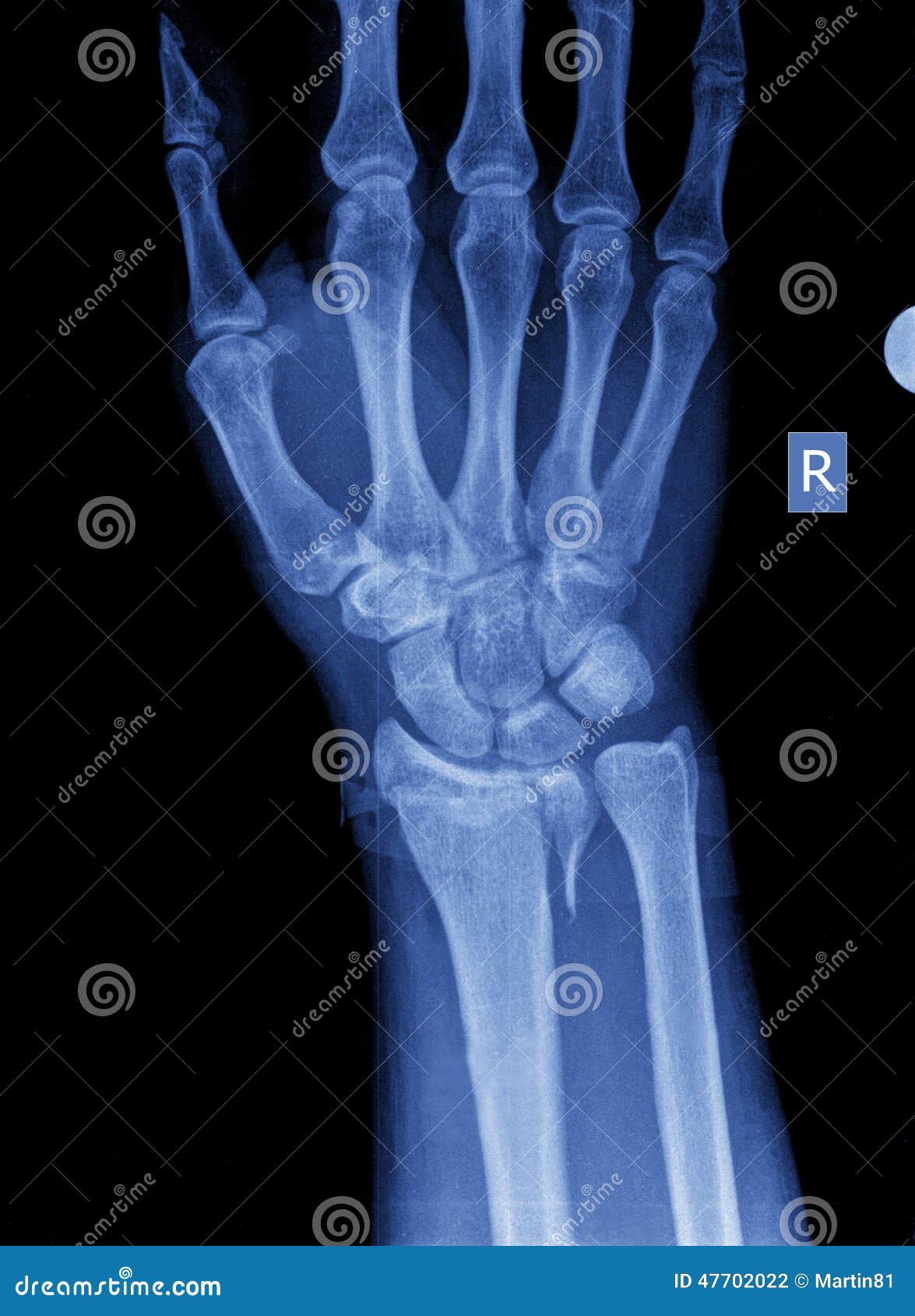 X-ray of hand stock photo. Image of hand, anesthetic - 47702022
