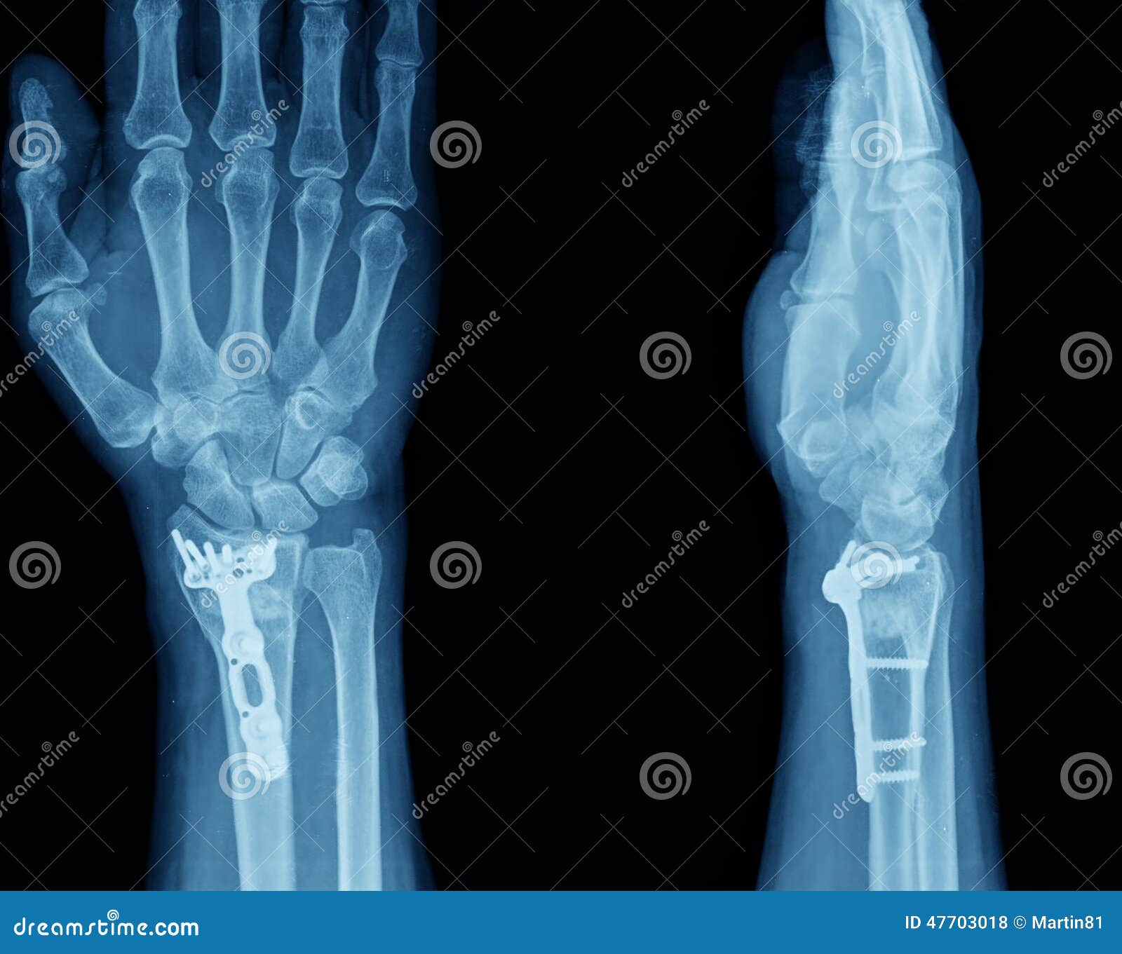 X-ray of hand stock photo. Image of medicine, imaging - 47703018