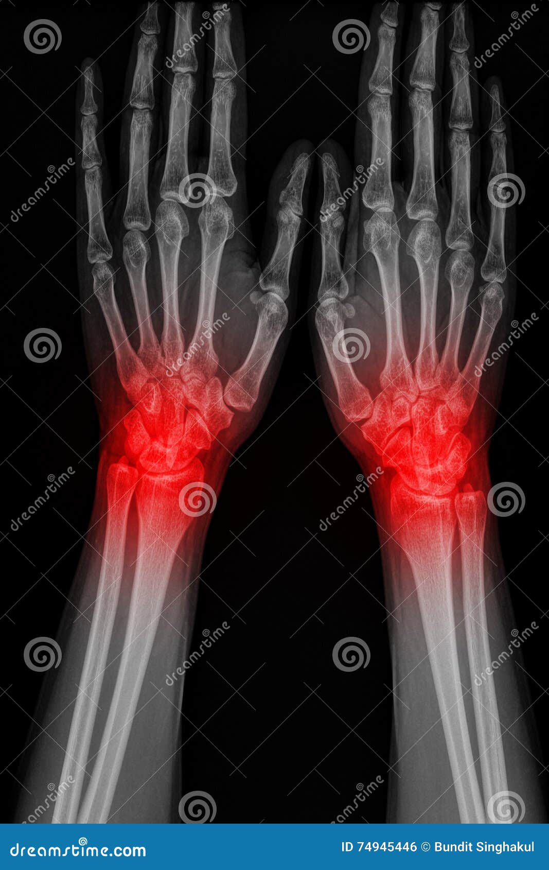 Radiogram Of Hand. X-ray Or Roentgenogram. Vector Illustration Of ...