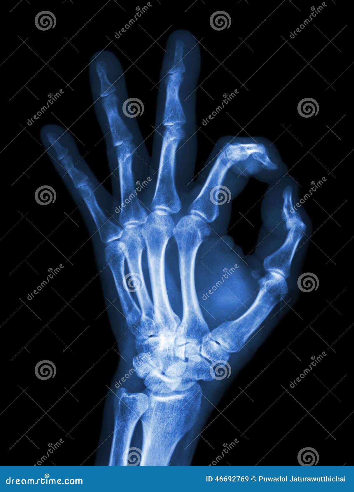 X-ray hand with OK symbol stock image. Image of hospital - 46692769