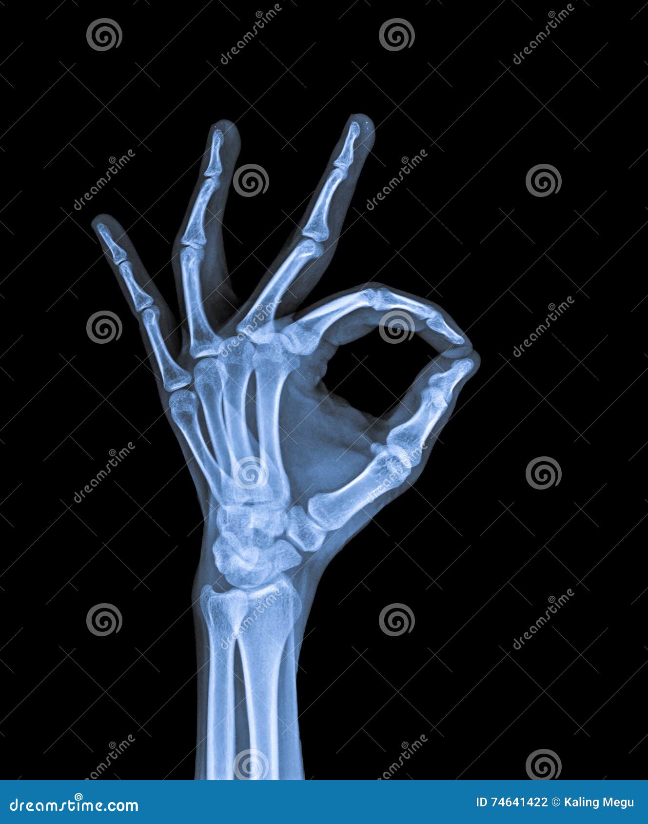 X Ray of hand. stock photo. Image of bone, care, check - 74641422