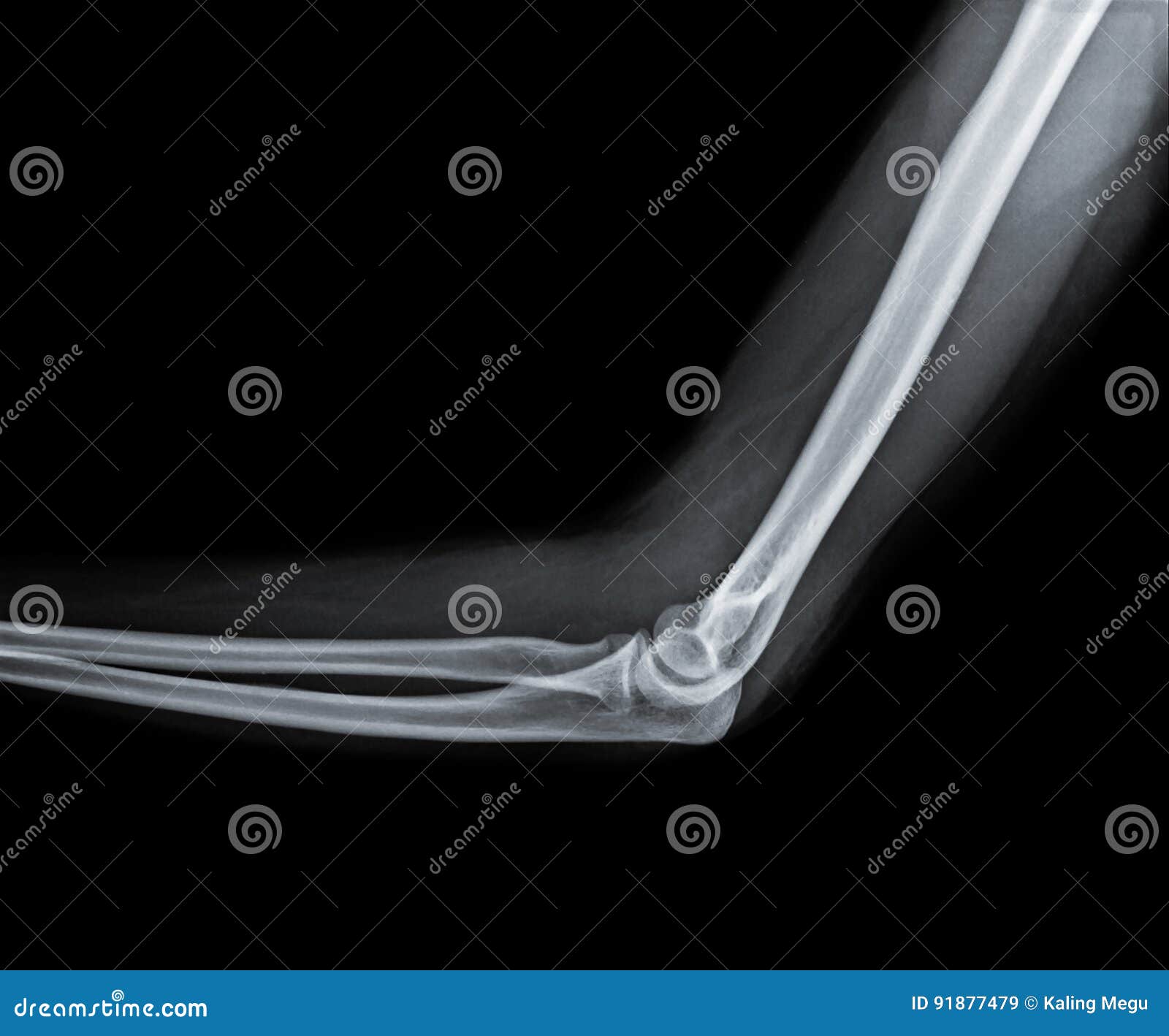 X Ray of Hand Showing Elbow Joint. Stock Image - Image of treatment ...