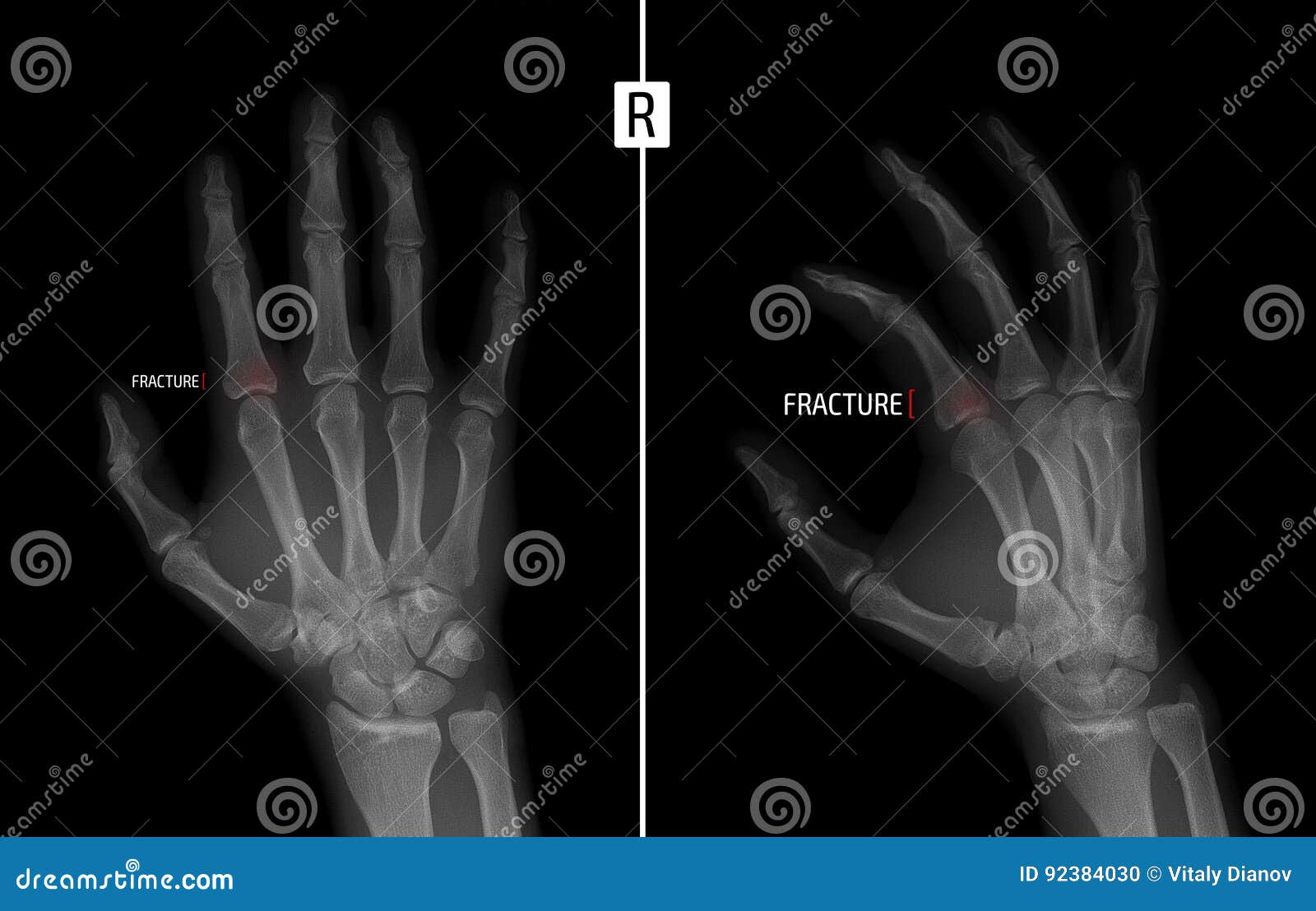 X-ray Of The Hand. Shows The Fracture Of The Base Of The Proximal ...