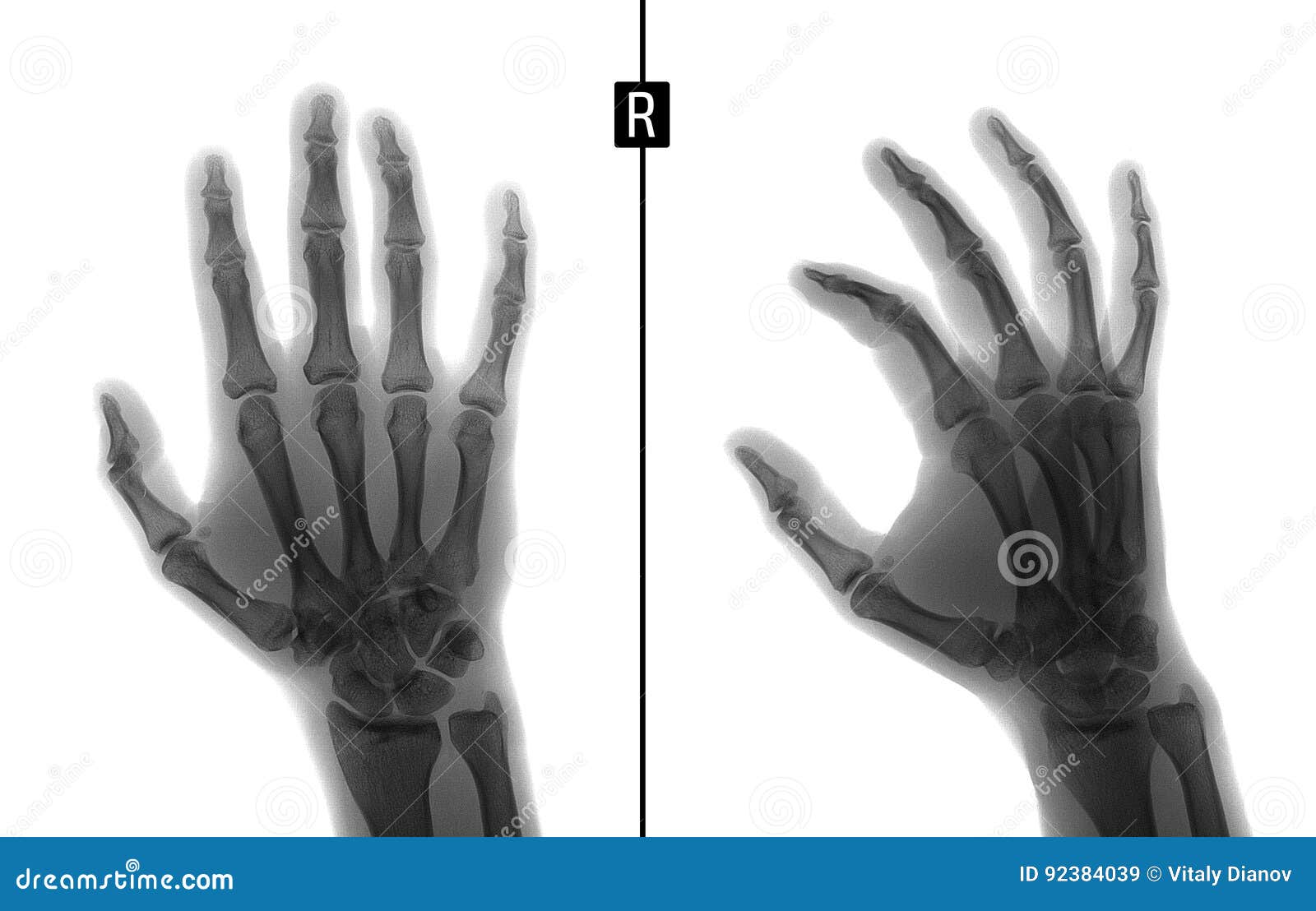 X-ray of the Hand. Shows the Fracture of the Base of the Proximal ...