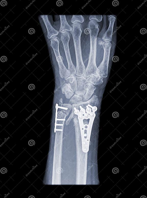 X-ray of Hand after Surgery Stock Image - Image of health, body: 14031521