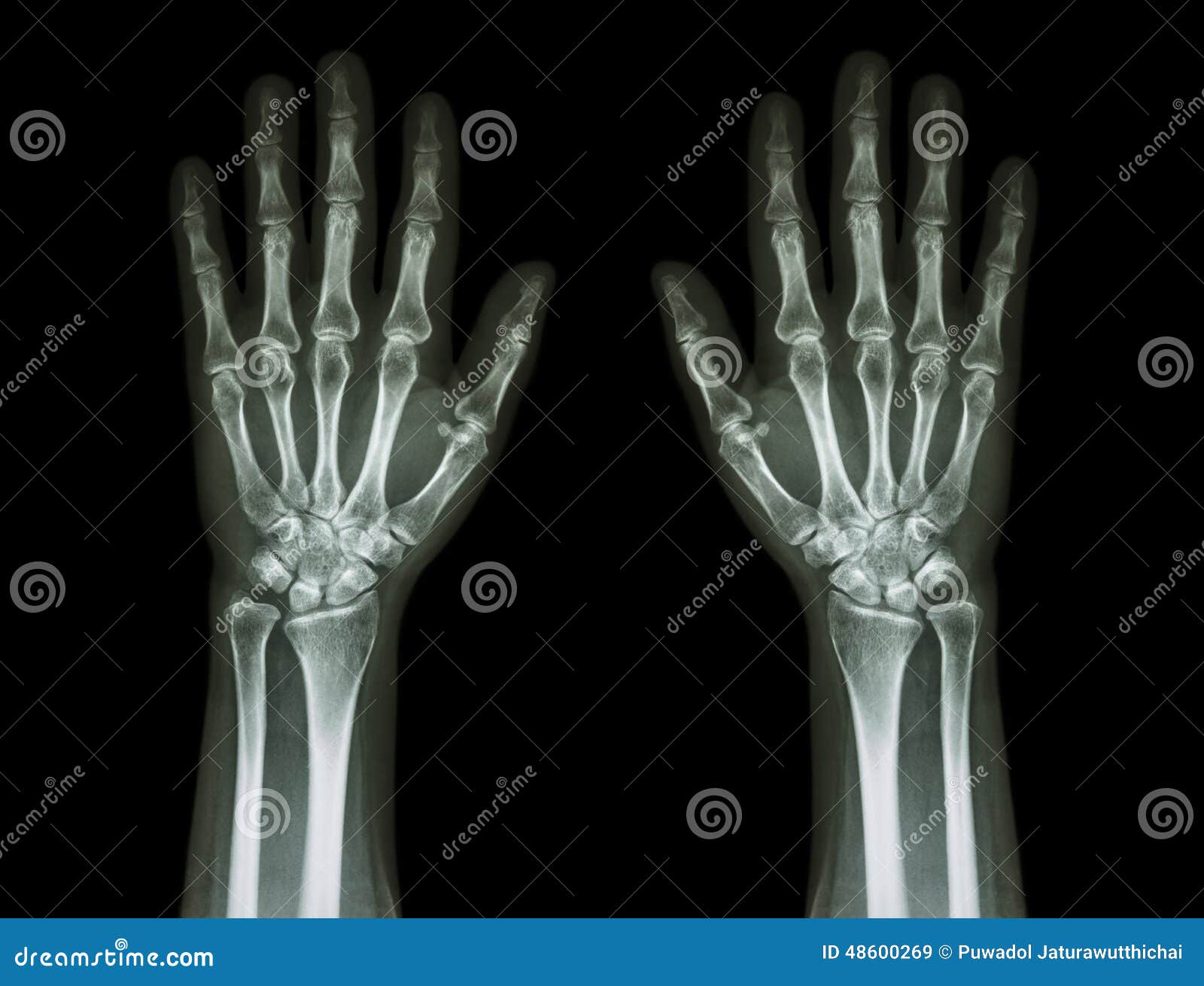 X Ray Hand Normal