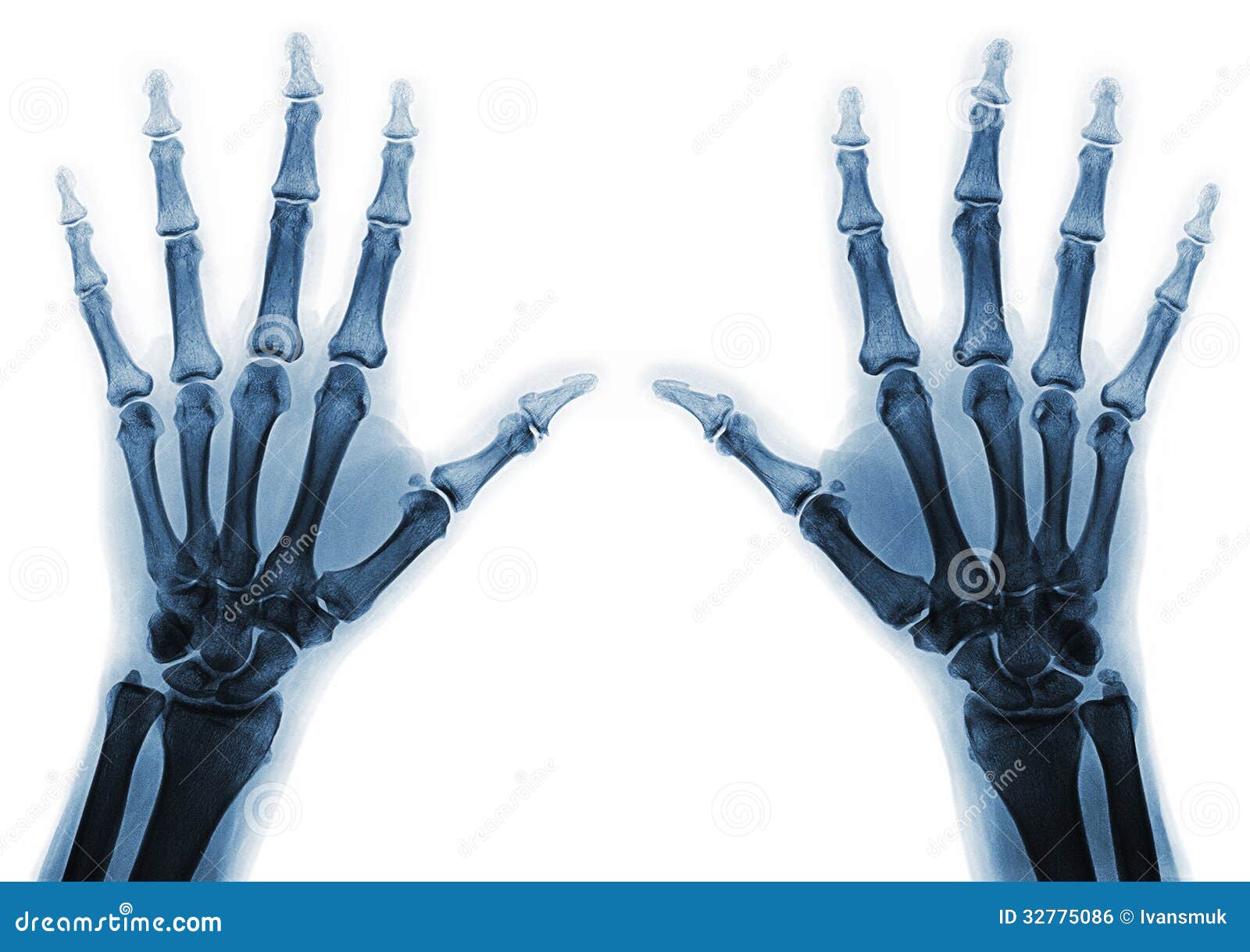 X-ray hands stock photo. Image of injury, arms, diagnostic - 32775086