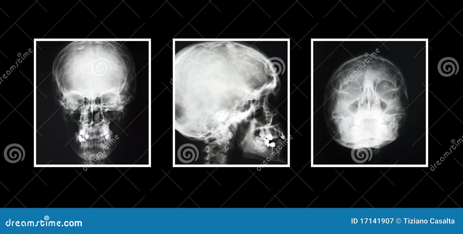 X-ray head stock image. Image of radiography, head, clinical - 17141907