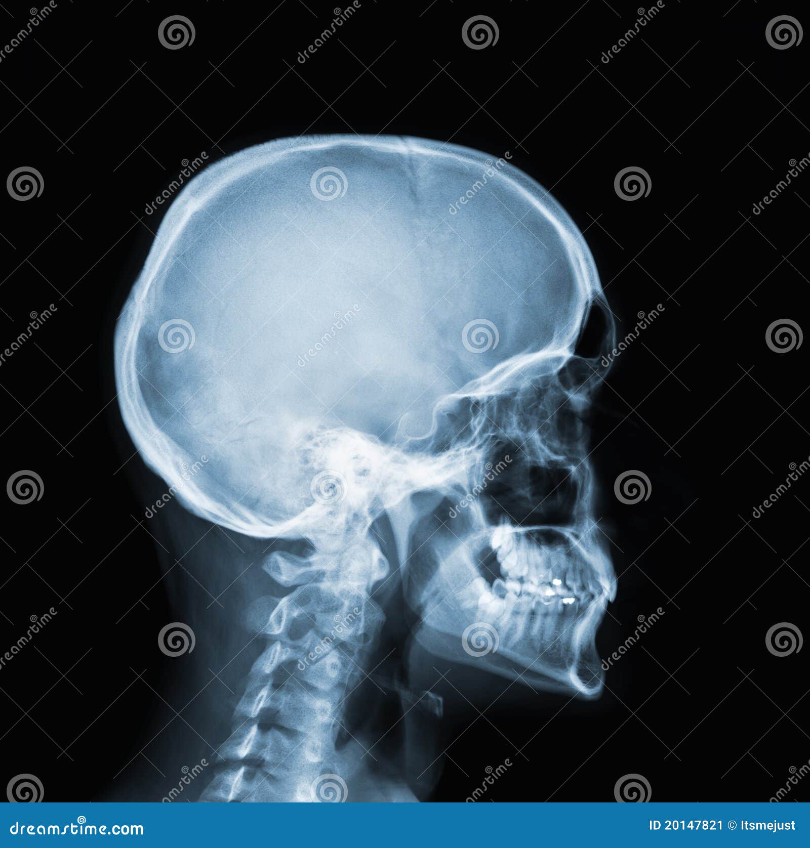 X-ray of head stock image. Image of medical, bone, painful - 20147821