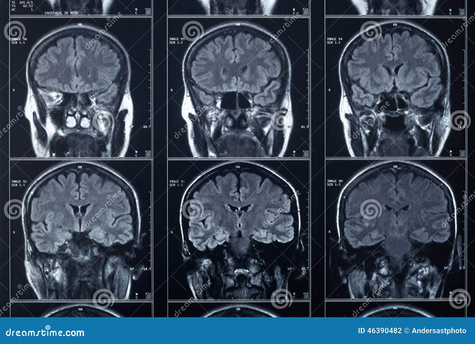 X-ray Head and Brain, Medical Exam Stock Photo - Image of head, broken ...