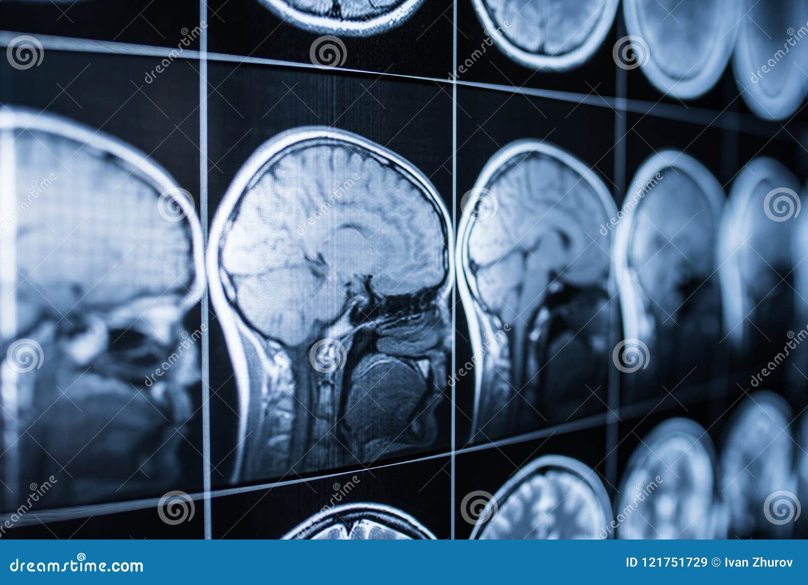 X-ray of the Head and Brain of a Person Stock Image - Image of care ...