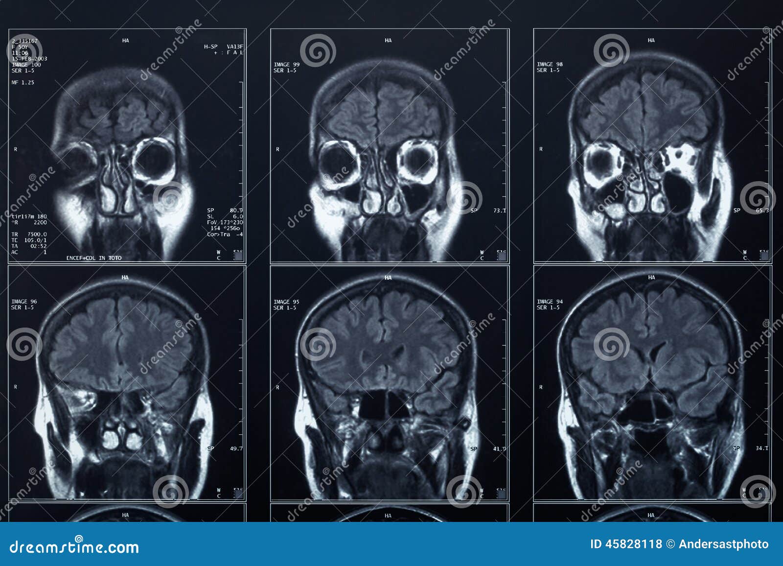 X-ray Head and Brain Radiography Stock Photo - Image of surgery ...