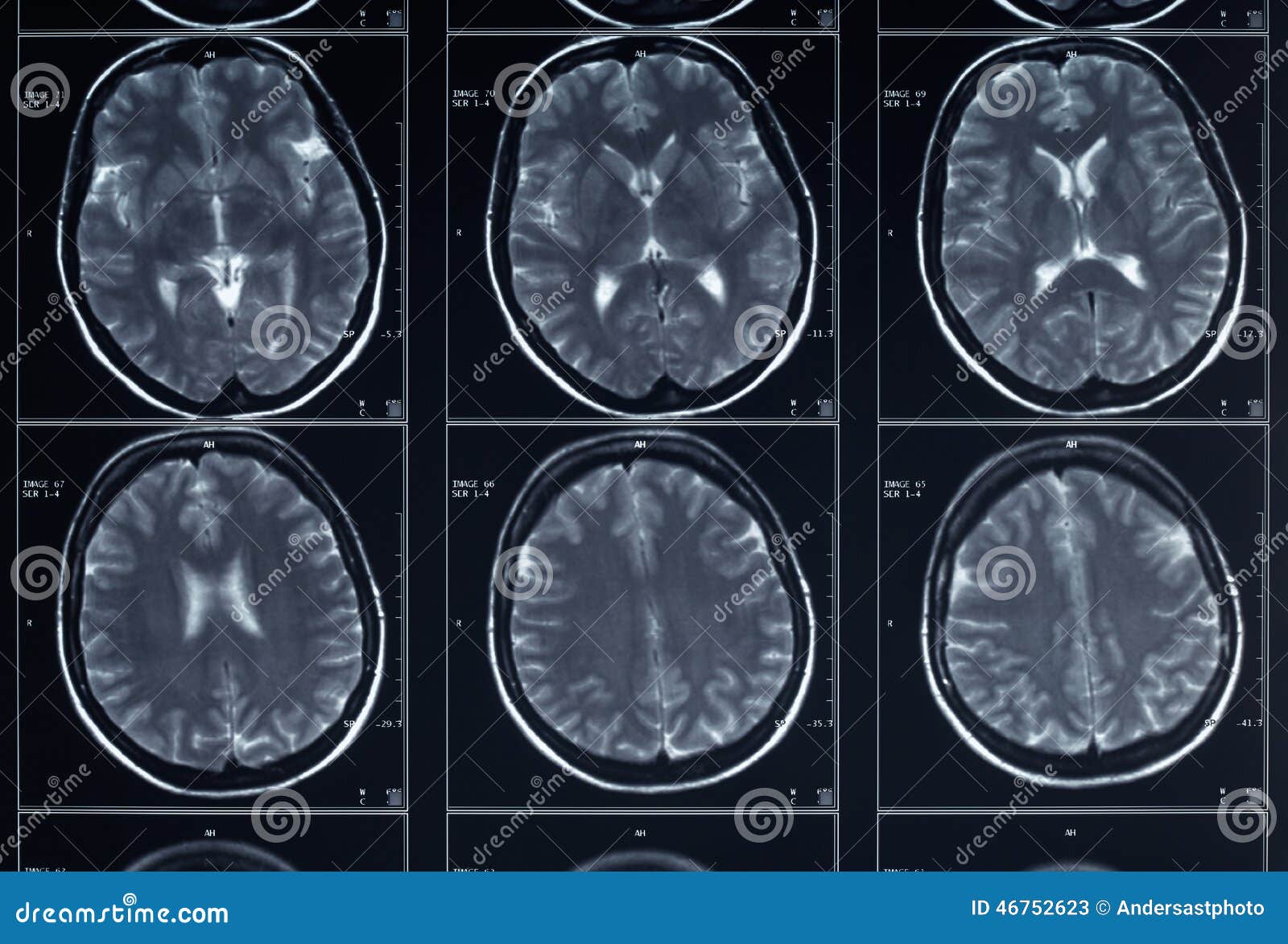 X-ray Head and Brain Radiography Stock Image - Image of diagnostic ...