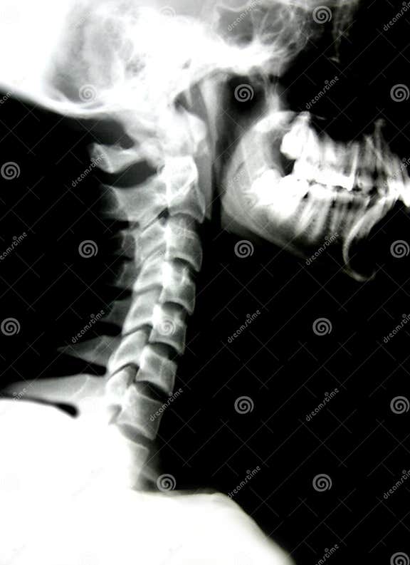 X-ray of head and neck stock photo. Image of medical, test - 2781464
