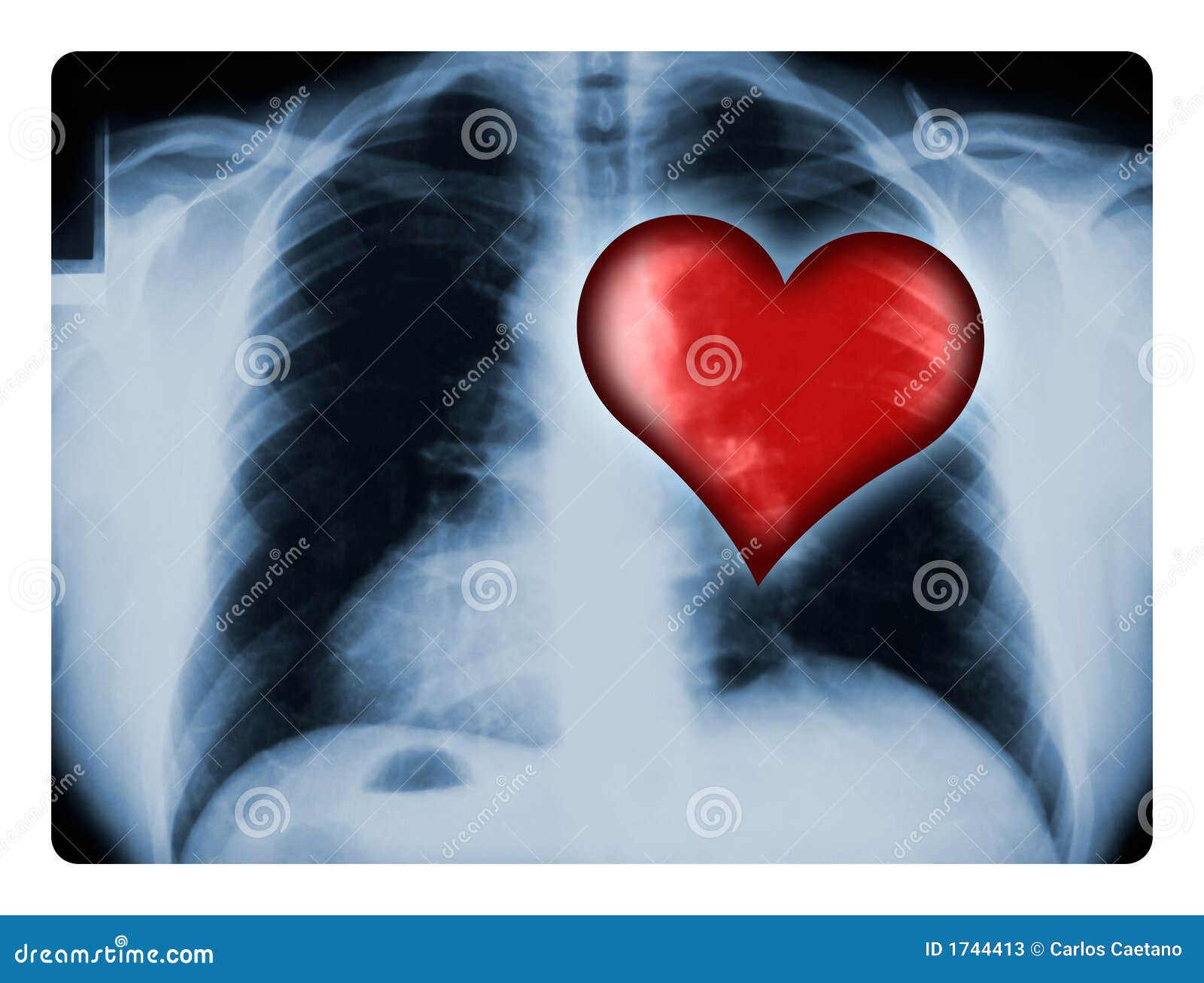 X-ray and Heart stock image. Image of idea, passion, chest - 1744413