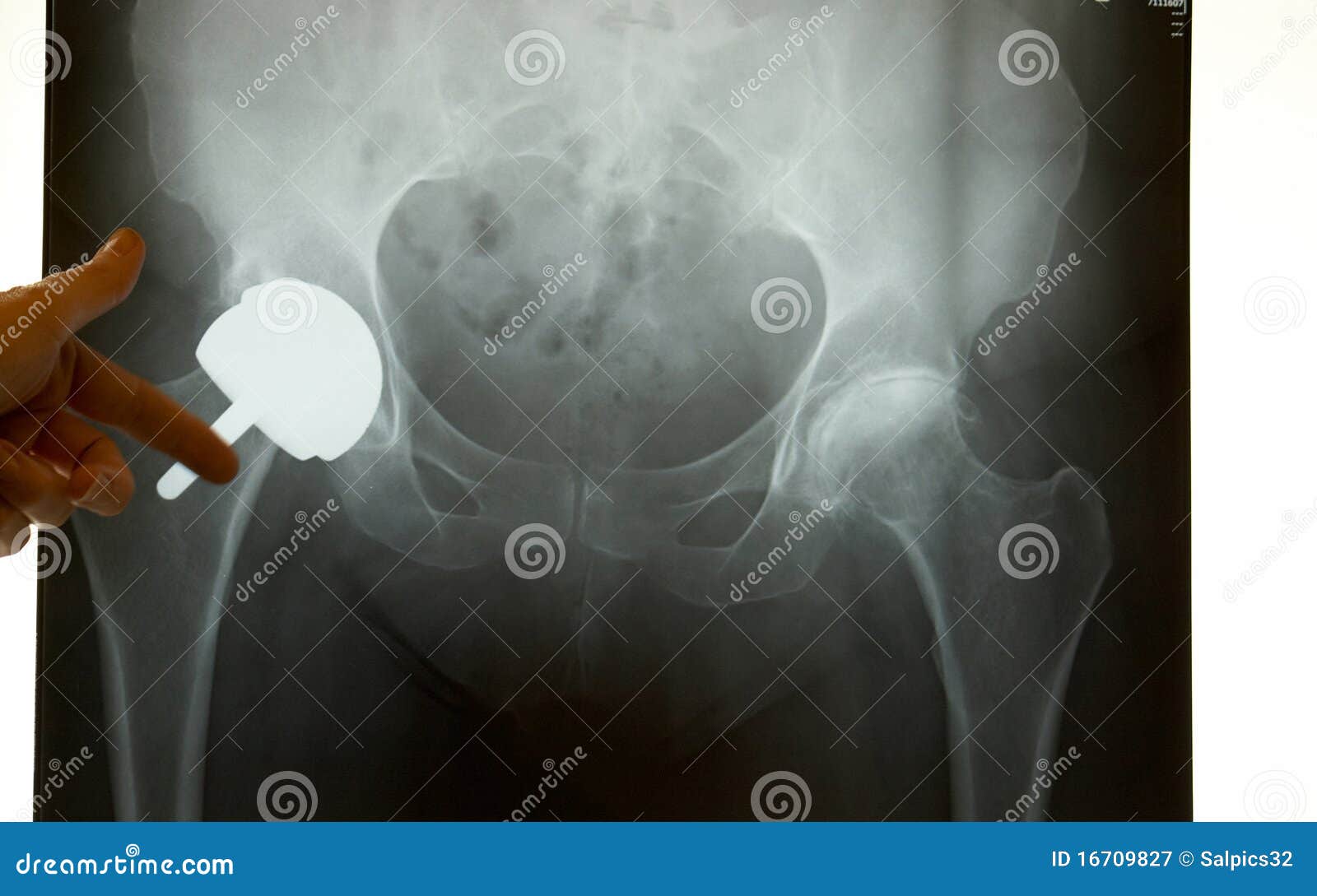 X-ray of a Hip Prosthesis stock image. Image of teaching - 16709827