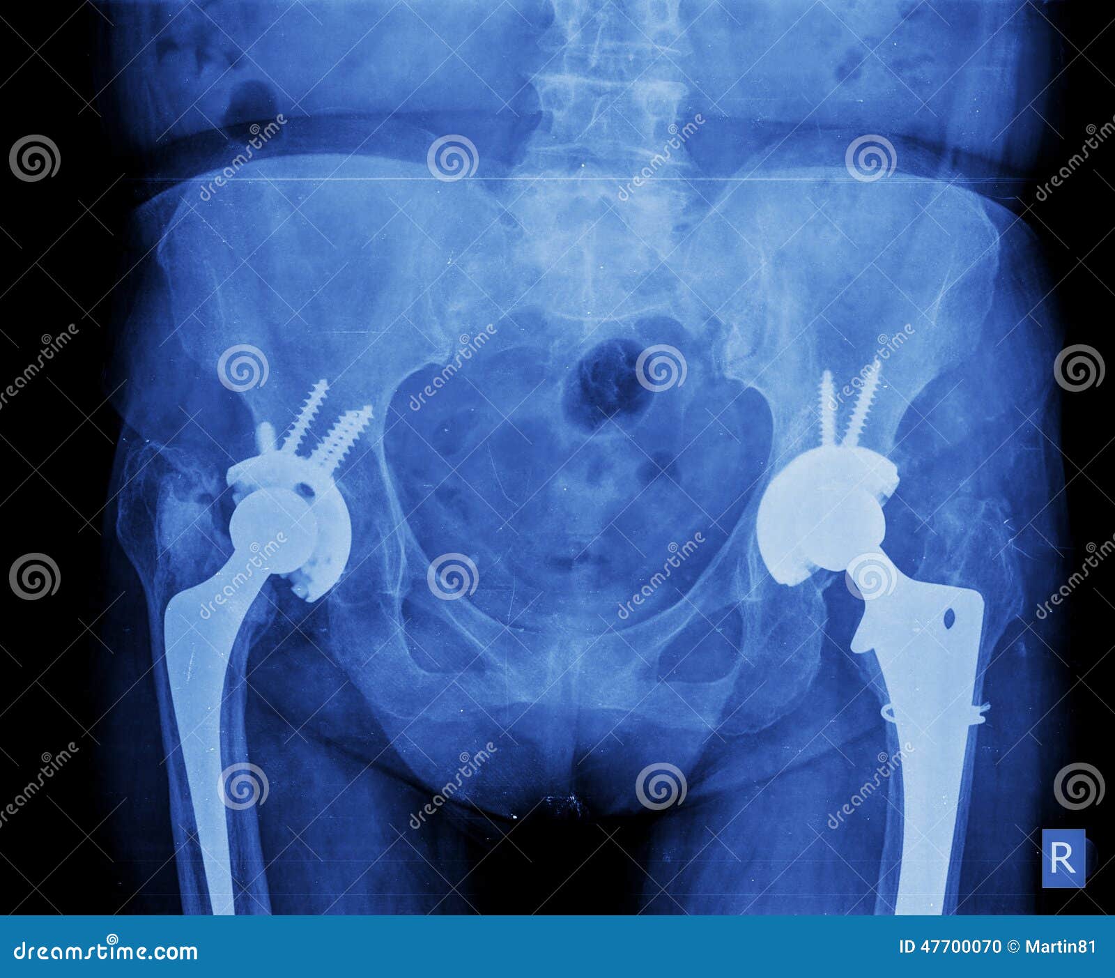 X-ray of hip prosthesis stock photo. Image of body, osteoporosis - 47700070