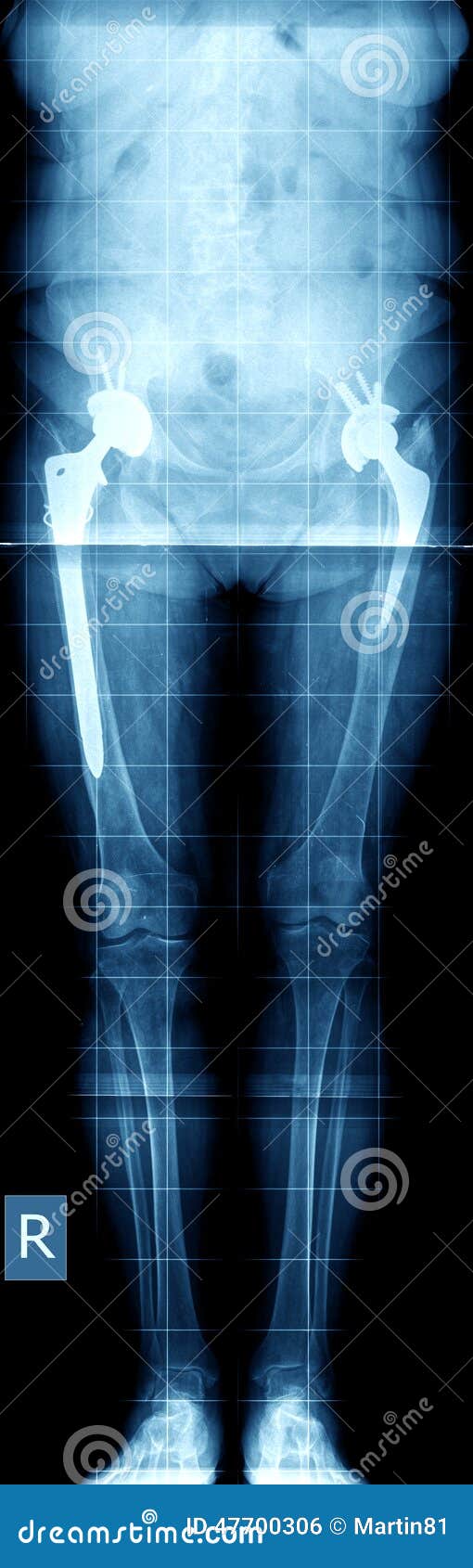 X-ray of hip prosthesis stock photo. Image of orthopedic - 47700306