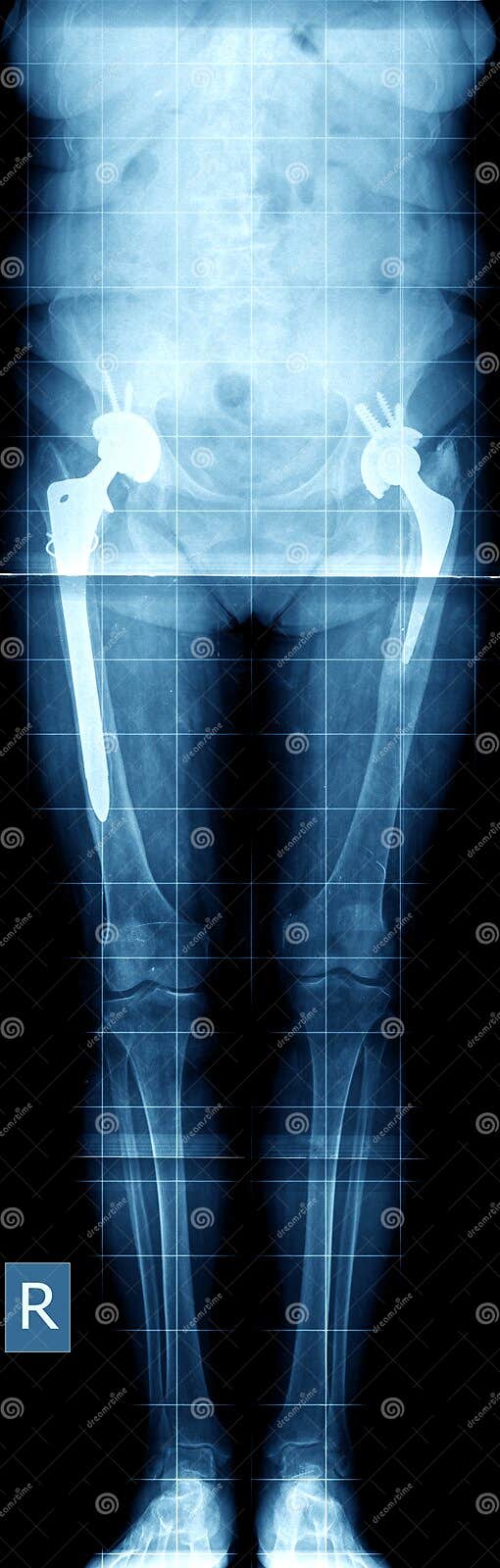 X-ray of hip prosthesis stock photo. Image of orthopedic - 47700306