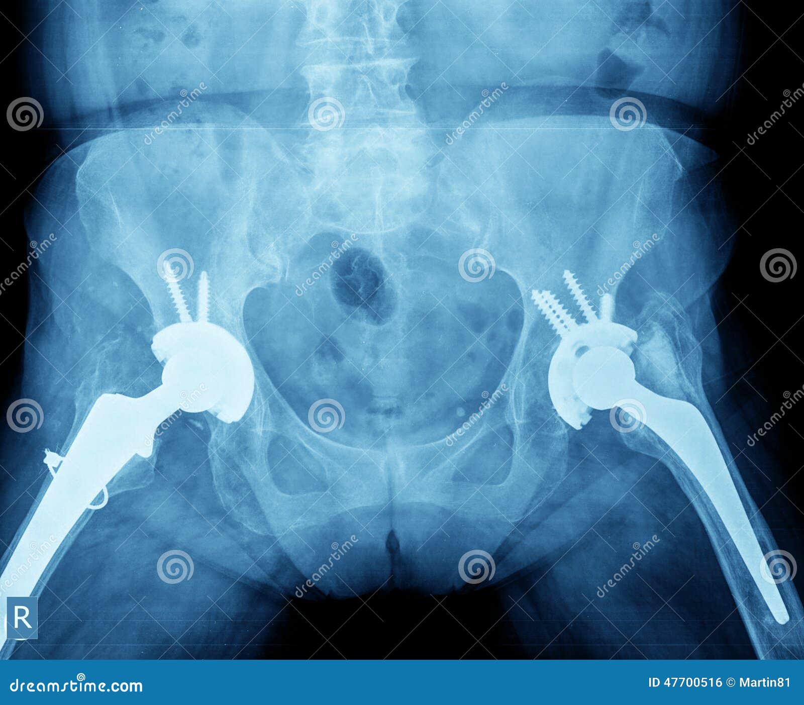 X-ray of hip prosthesis stock photo. Image of medical - 47700516