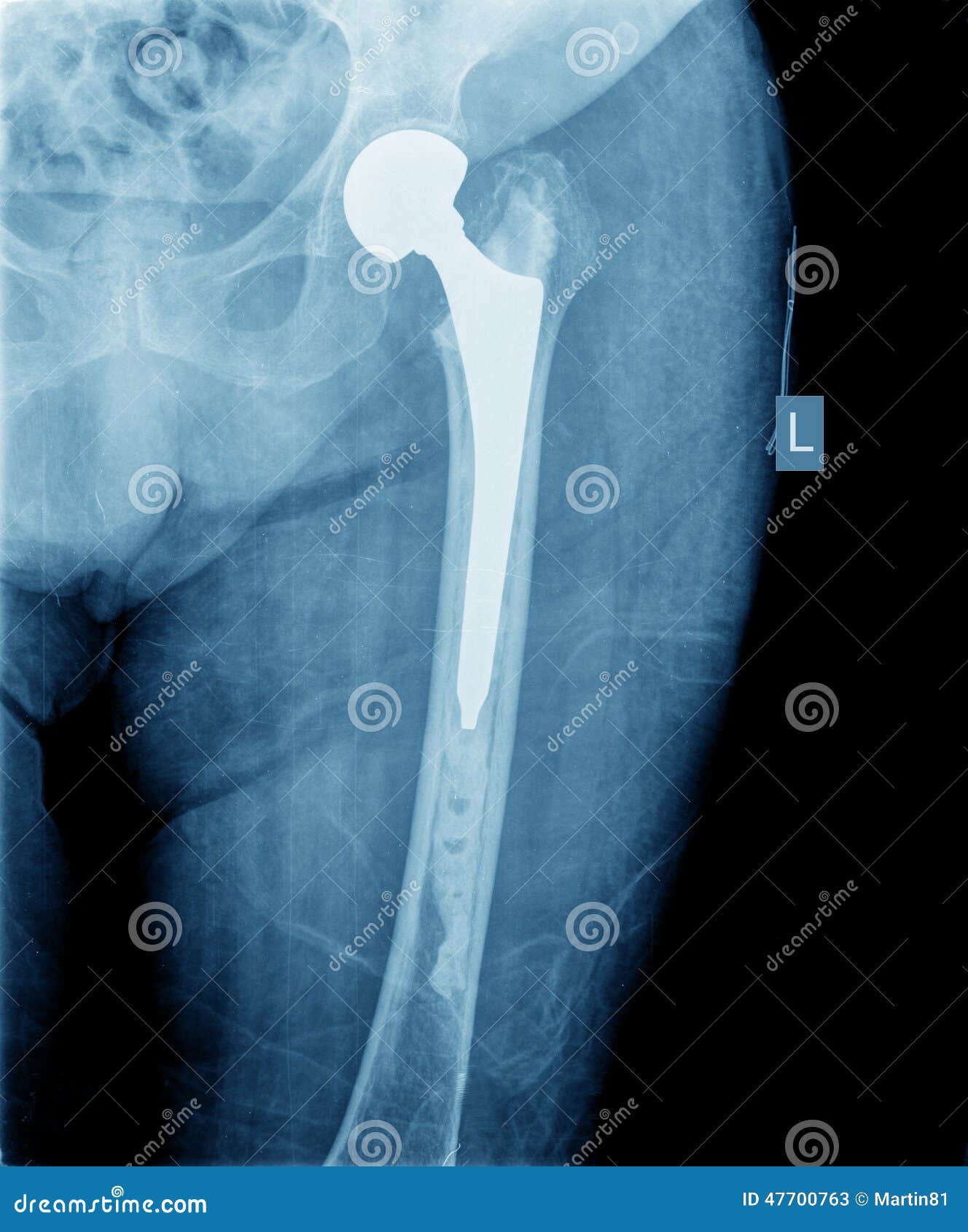X-ray of hip prosthesis stock image. Image of endoprothese - 47700763
