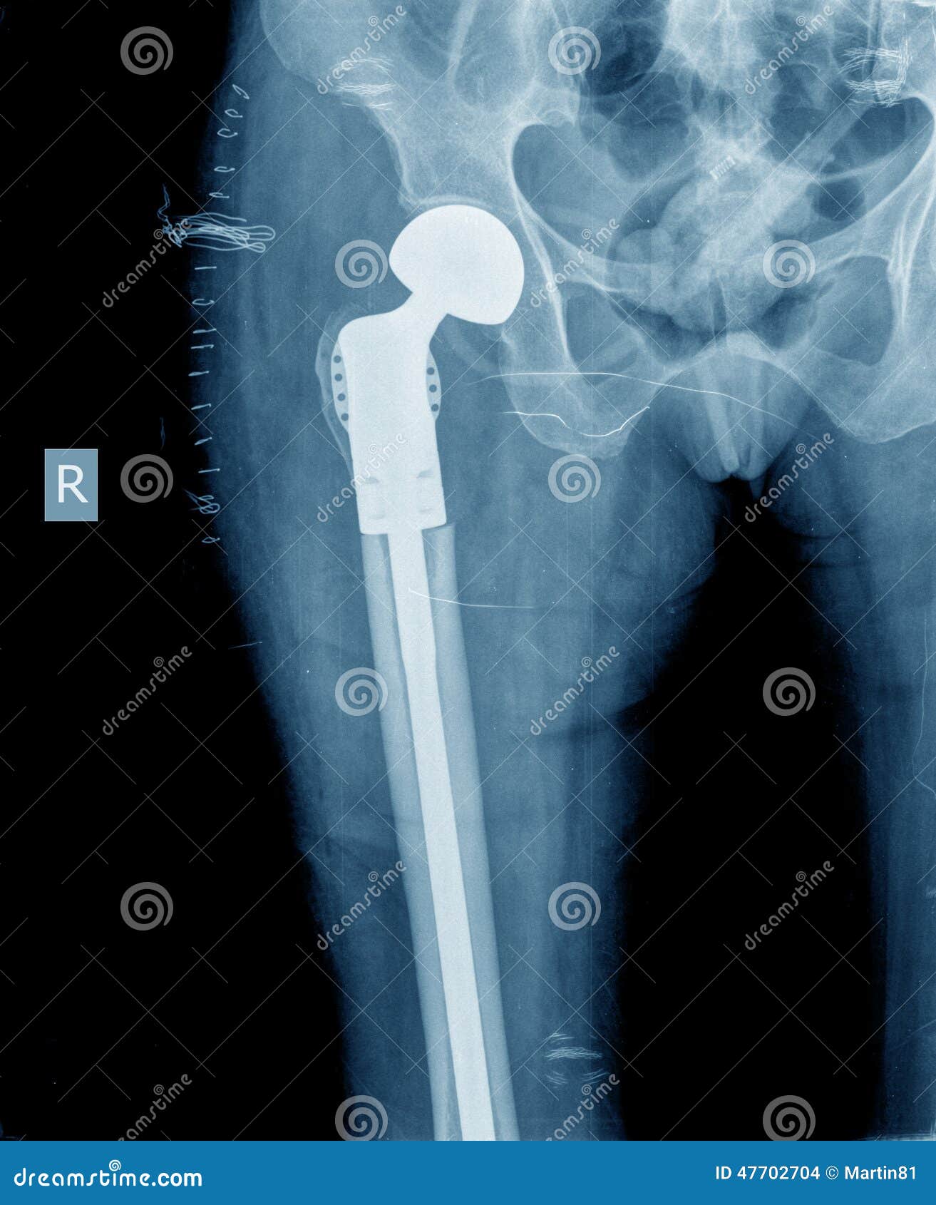 X-ray of hip prosthesis stock photo. Image of bone, pelvis - 47702704